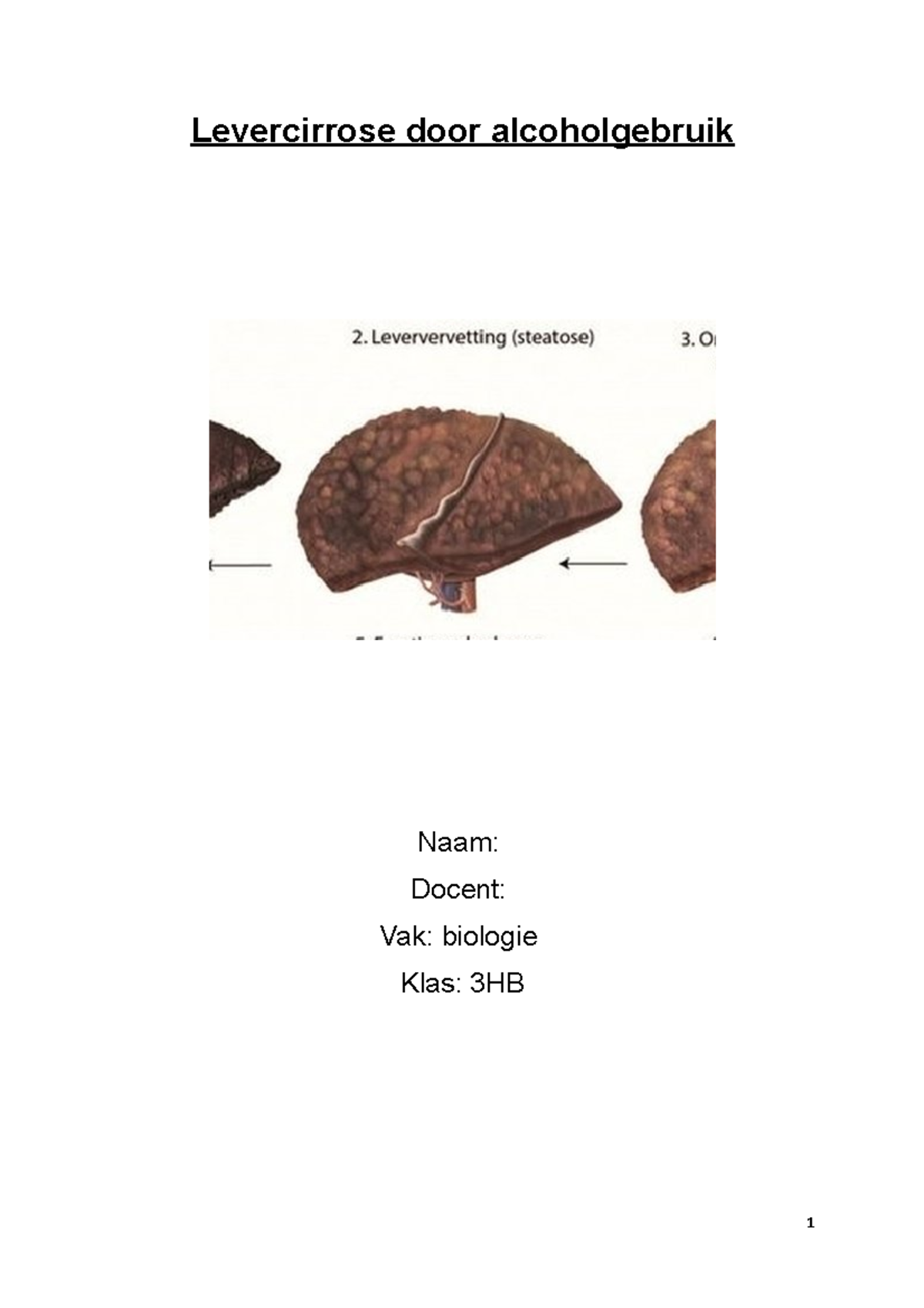 Levercirrose door alcoholgebruik - Levercirrose door alcoholgebruik ...