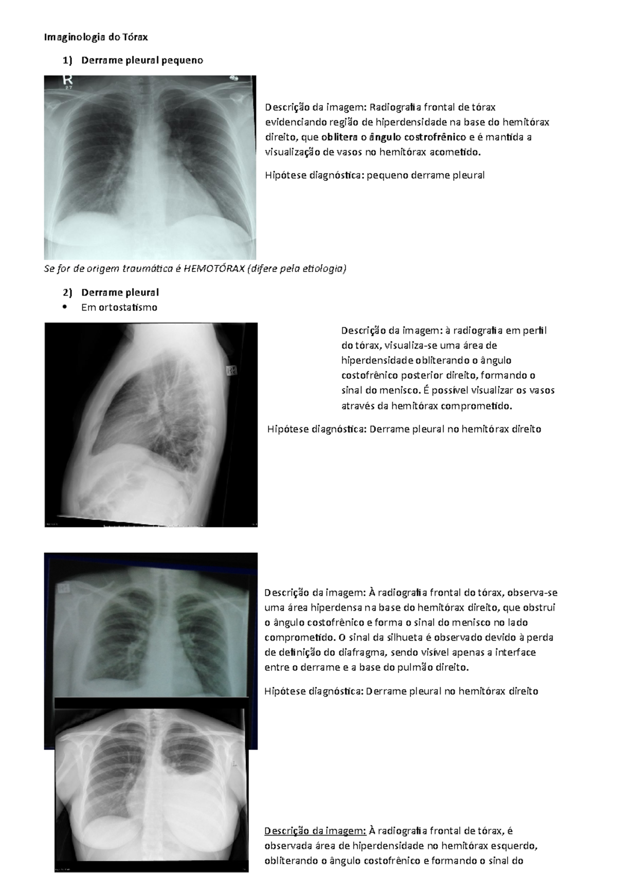 Torax radiologia - Imaginologia do Tórax 1) Derrame pleural pequeno ...