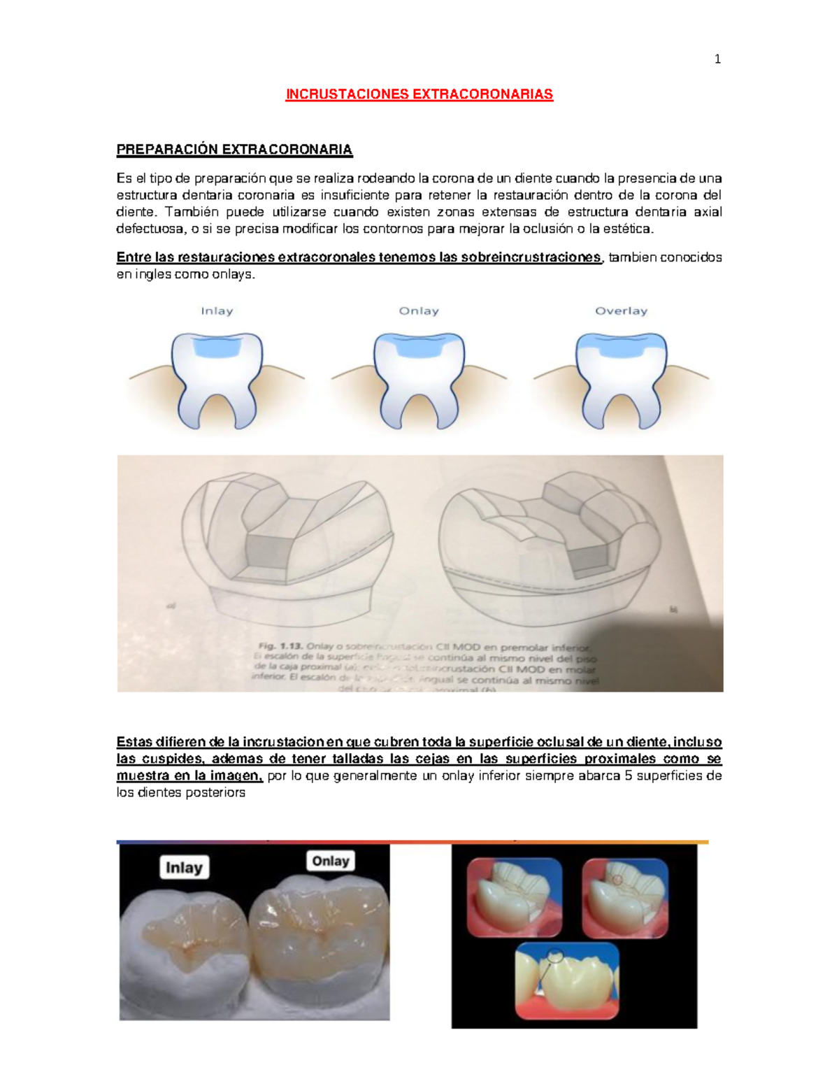 GUIA Prótesis REV Final - INCRUSTACIONES EXTRACORONARIAS PREPARACIÓN ...
