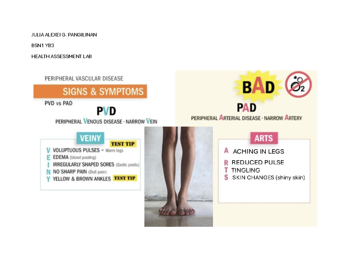 VENOUS INSUFFICIENCY - BS in Nursing - JULIA ALEXEI G. PANGILINAN BSN1 ...