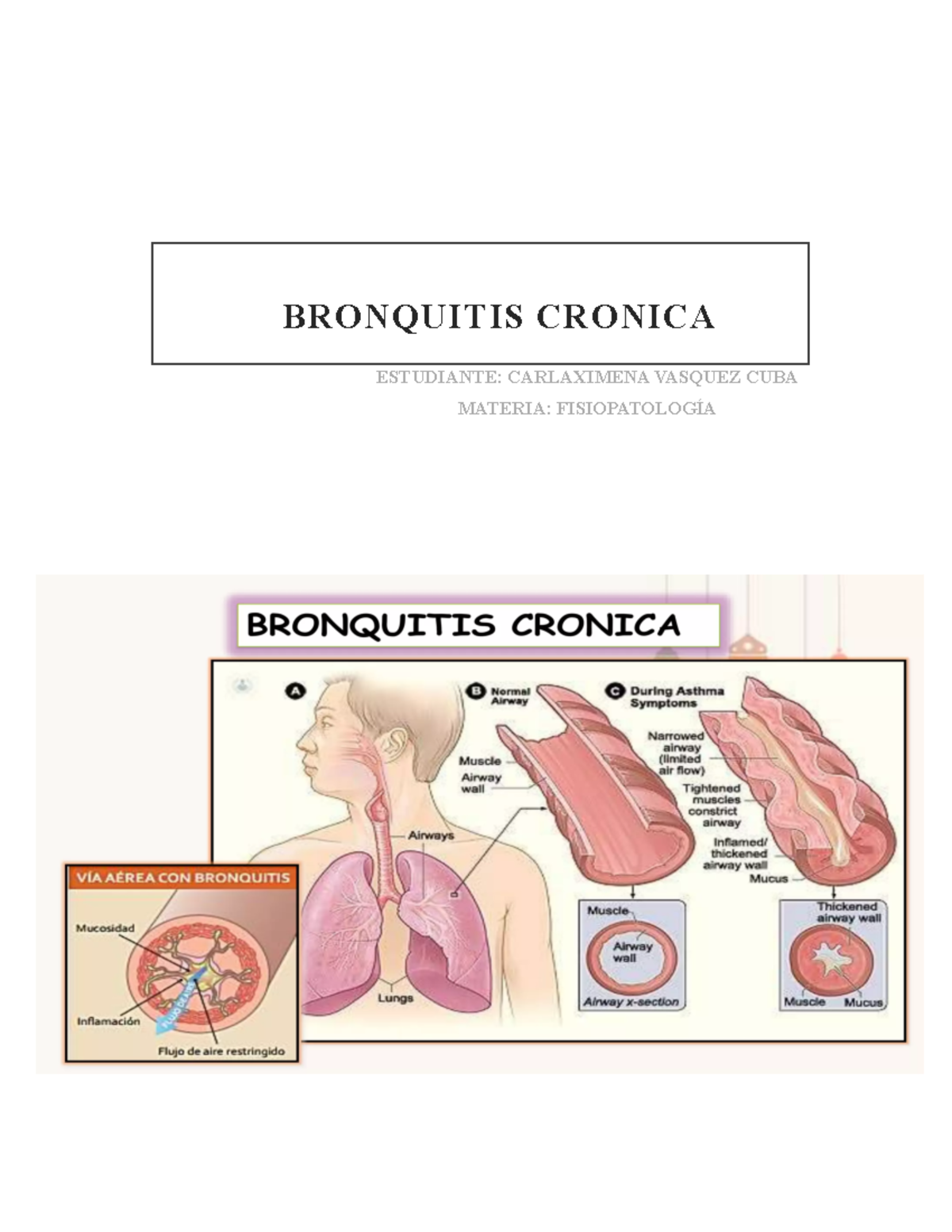 Bronquitis cronica - Fisiopatología - BRONQUITIS CRONICA ESTUDIANTE: CARLAXIMENA VASQUEZ CUBA ...