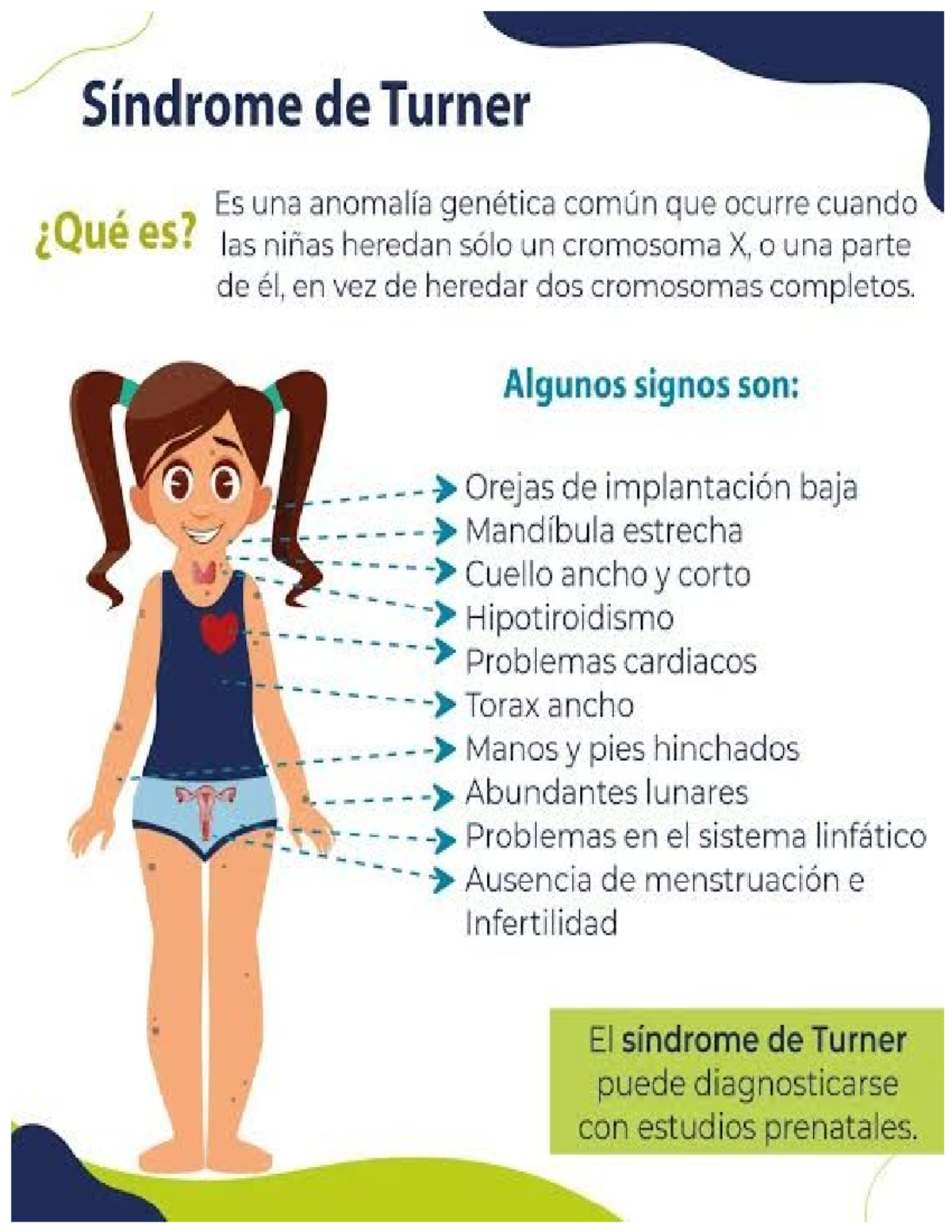 Turner - Medicina - Síndrome de Turner Es una anomalía genética común ...