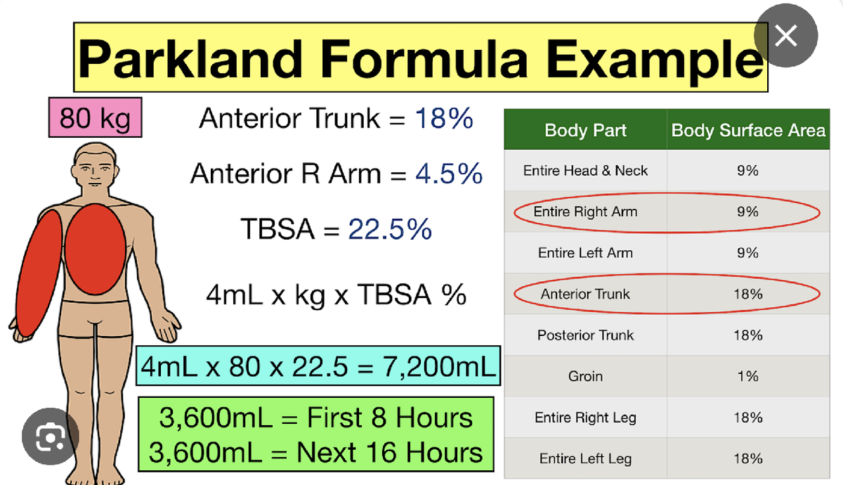 Png2pdf - Rule of 9's - X Parkland Formula Example 80 kg Anterior Trunk ...