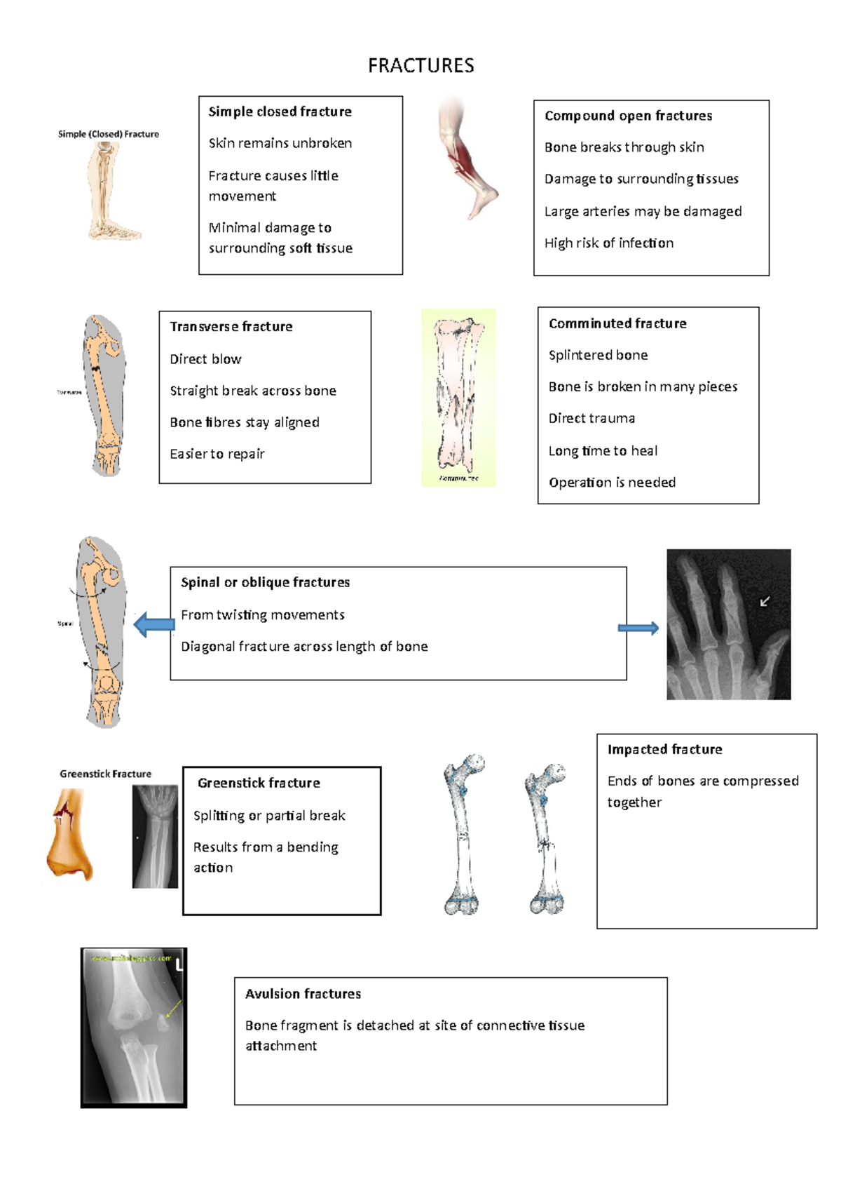 Fractures - FRACTURES Greenstick fracture Splitting or partial break ...