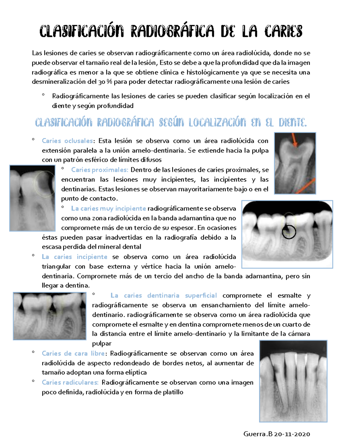 Clasificacion radiografica de la caries - Guerra 20- 11 - Las lesiones ...