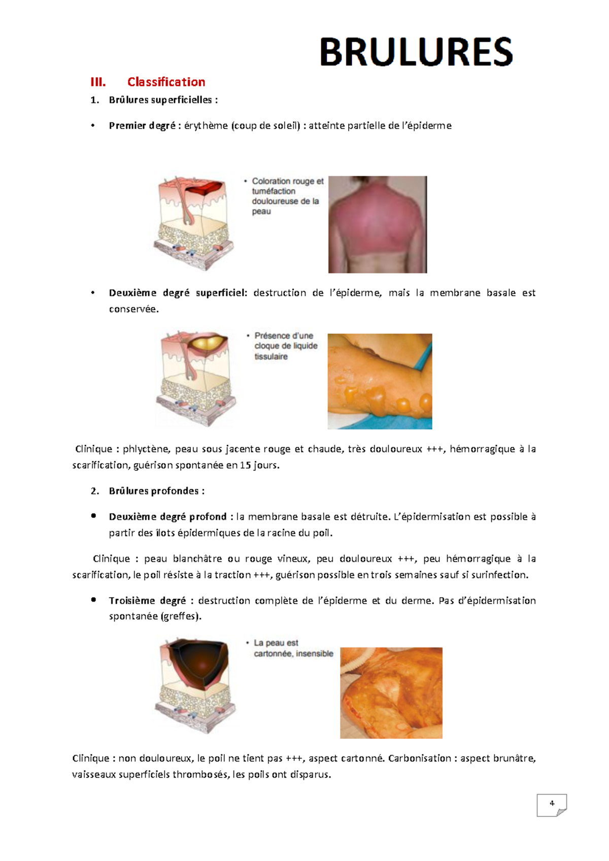 Brûlures et blast - III. Classification Brûlures superficielles ...