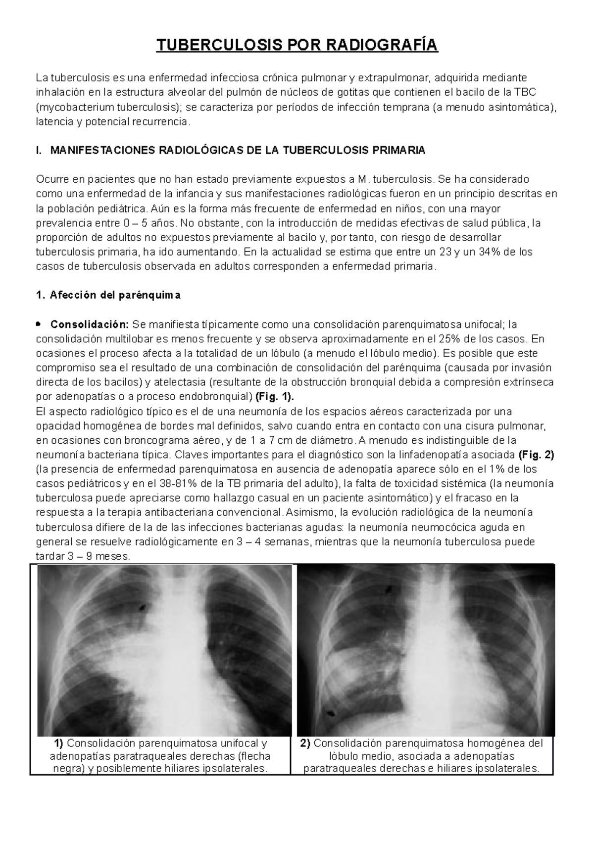 Tuberculosis POR Radiografía - TUBERCULOSIS POR RADIOGRAFÍA La ...