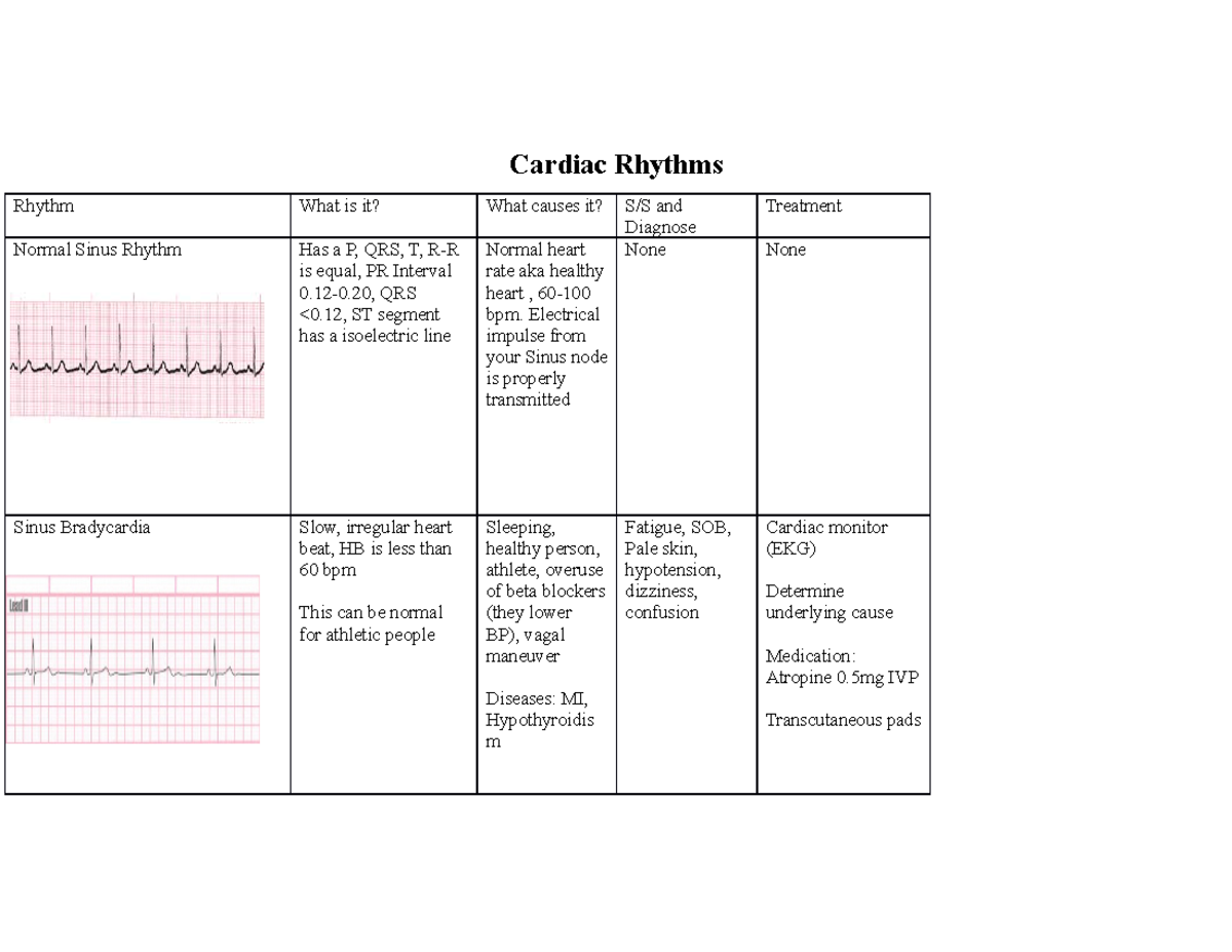 Cardiac Rhythms ms2 - Cardiac Rhythms Rhythm What is it? What causes it ...