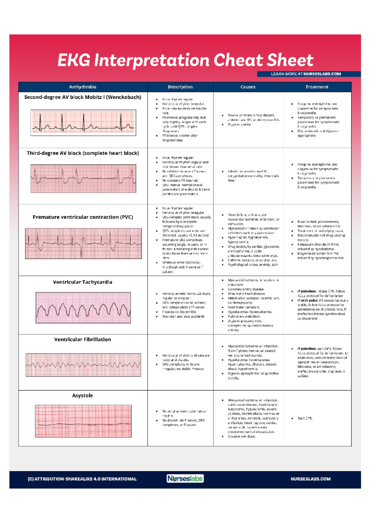 EKG Interpretation Cheat Sheet - Ventricular rhythm irregular. Atropine ...