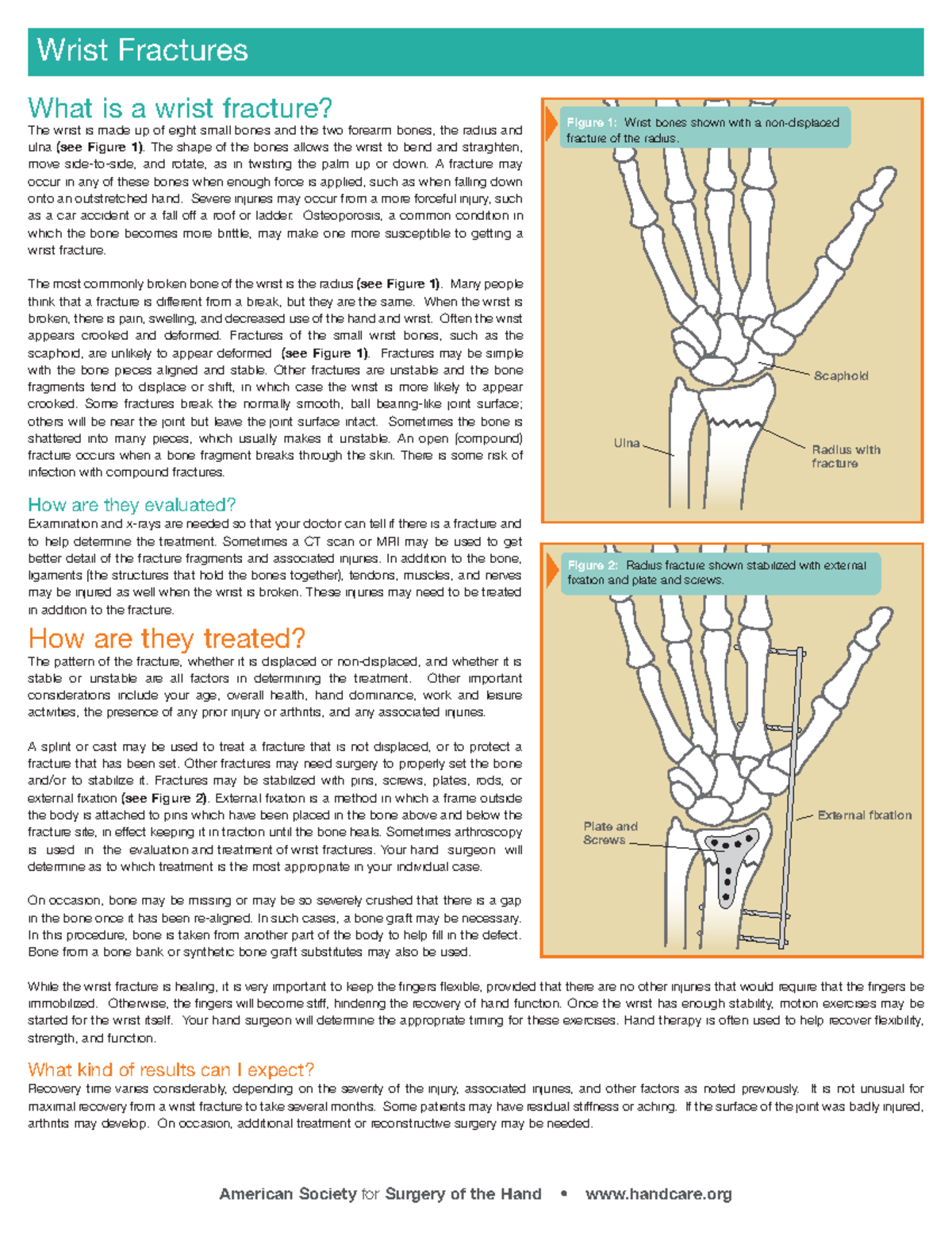 Wrist fracture - What is a wrist fracture? The wrist is made up of ...