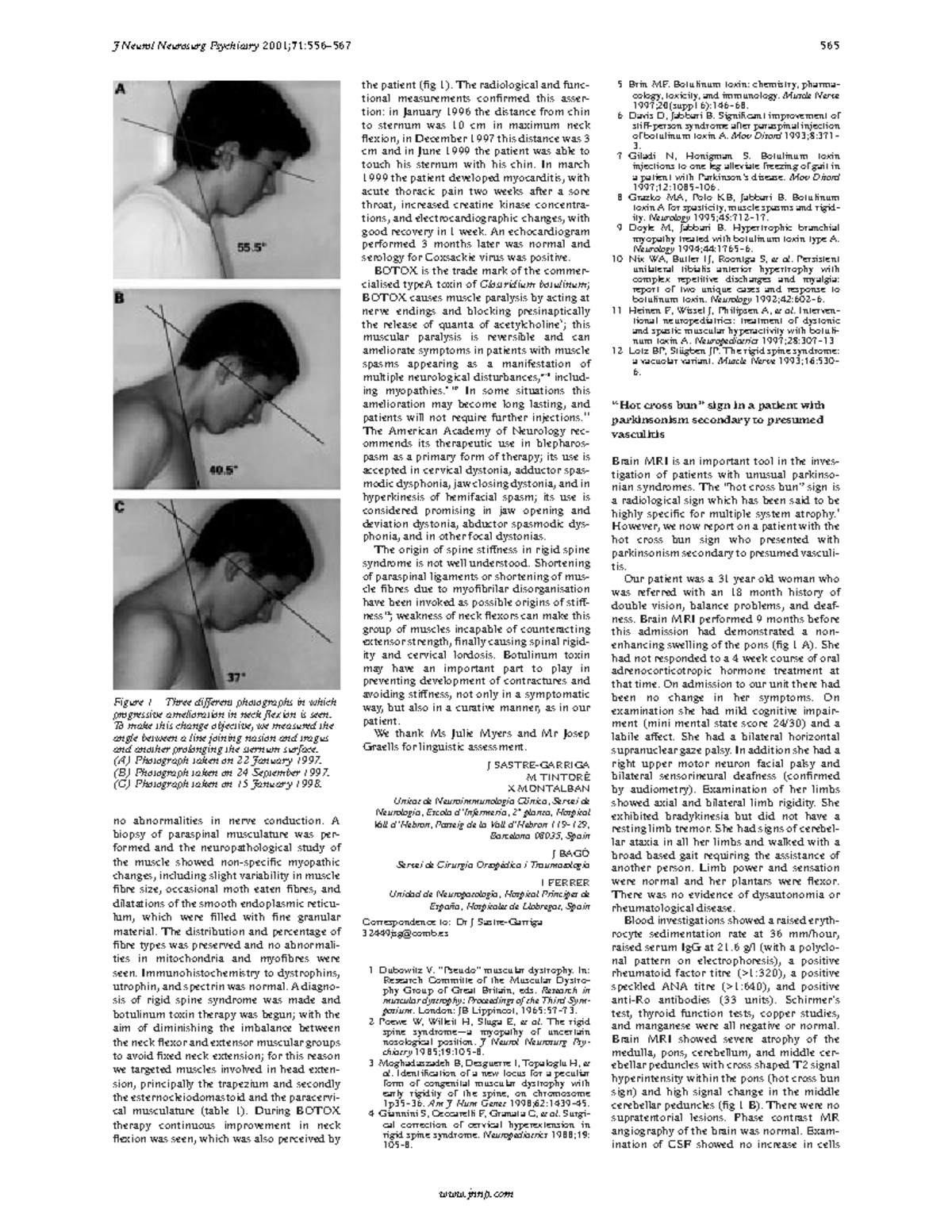 “Hot cross bun” sign in a patient with parkinsonism secondary to ...