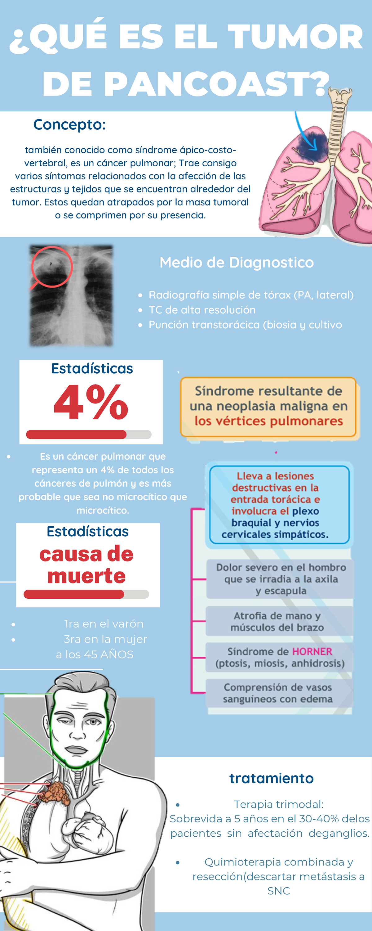 Infografia medicina profesional celeste - ¿QUÉ ES EL TUMOR DE PANCOAST ...