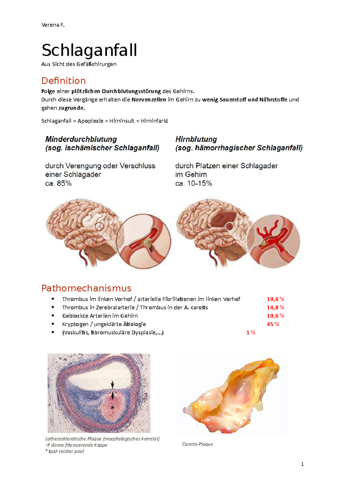 Schlaganfall - Vorlesungsnotizen gesamt - 1atherosklerotische Plaque ...