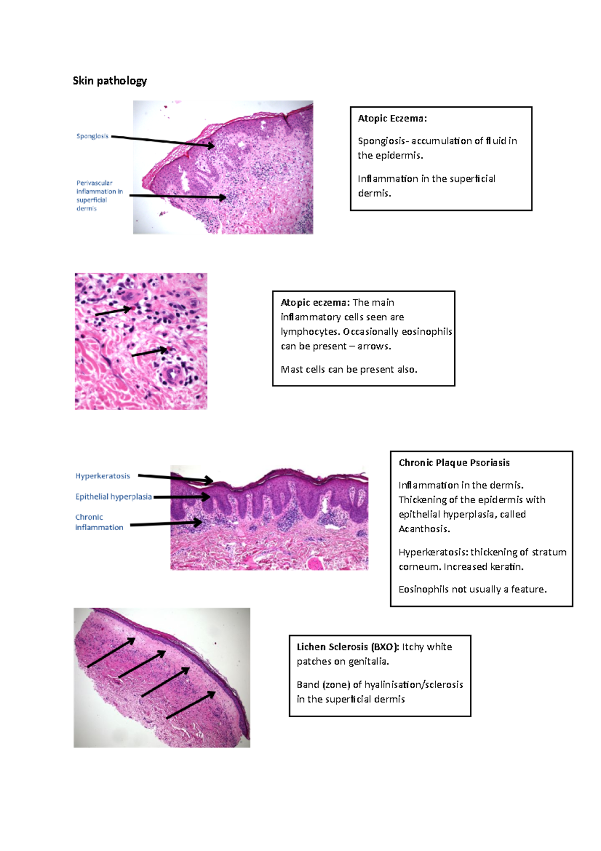 Skin pathology - Skin pathology Atopic Eczema: Spongiosis- accumulation ...