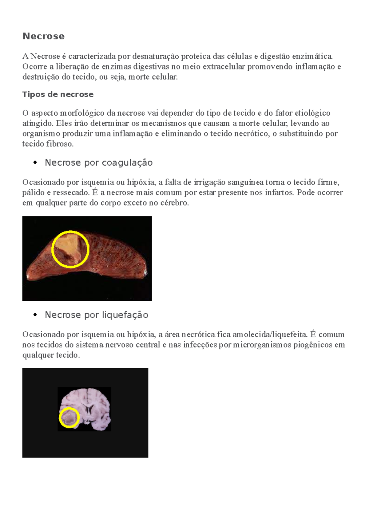 Tipos de necrose - Necrose A Necrose é caracterizada por desnaturação ...