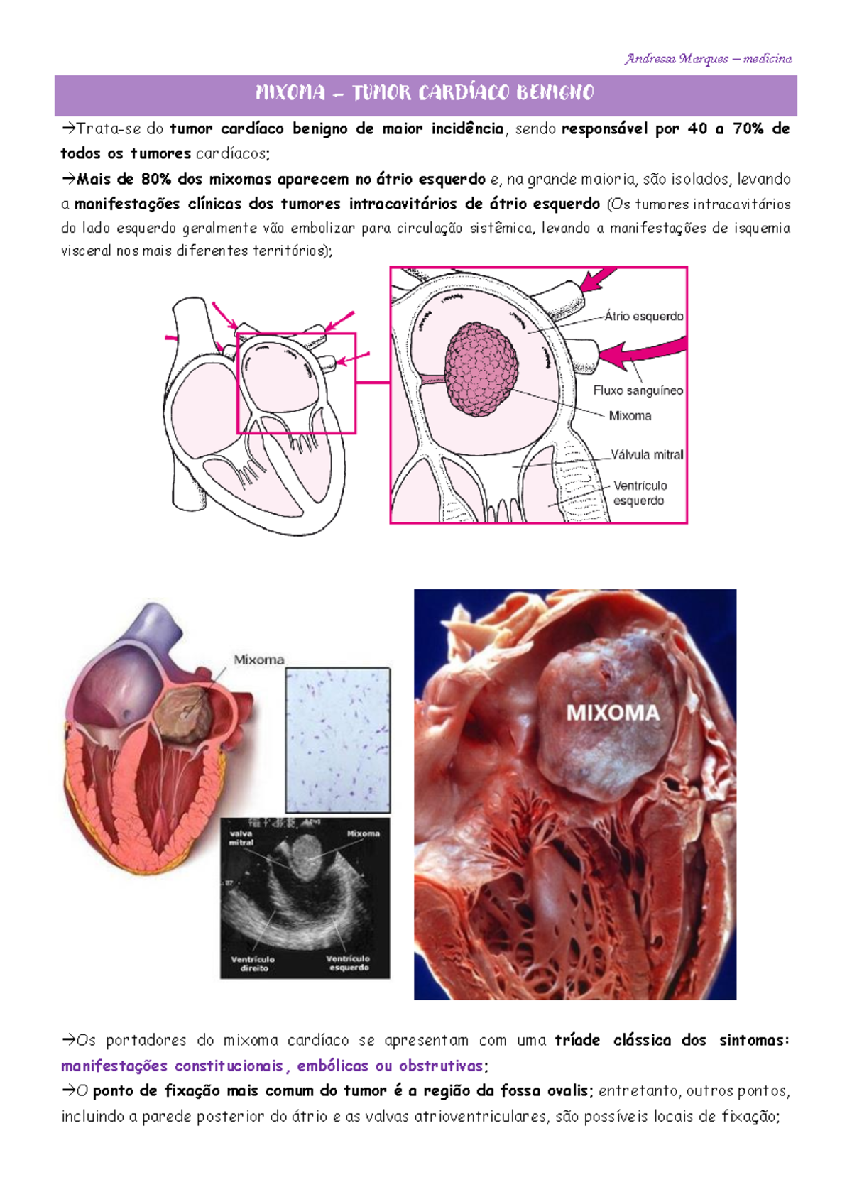 Mixoma - Andressa Marques – medicina MIXOMA – TUMOR CARDÍACO BENIGNO → ...