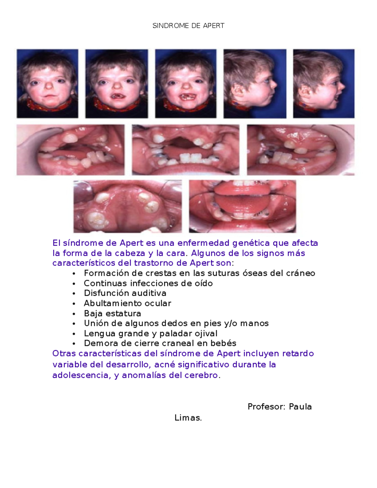 Sindrome DE Apert - ... - SINDROME DE APERT El síndrome de Apert es una ...