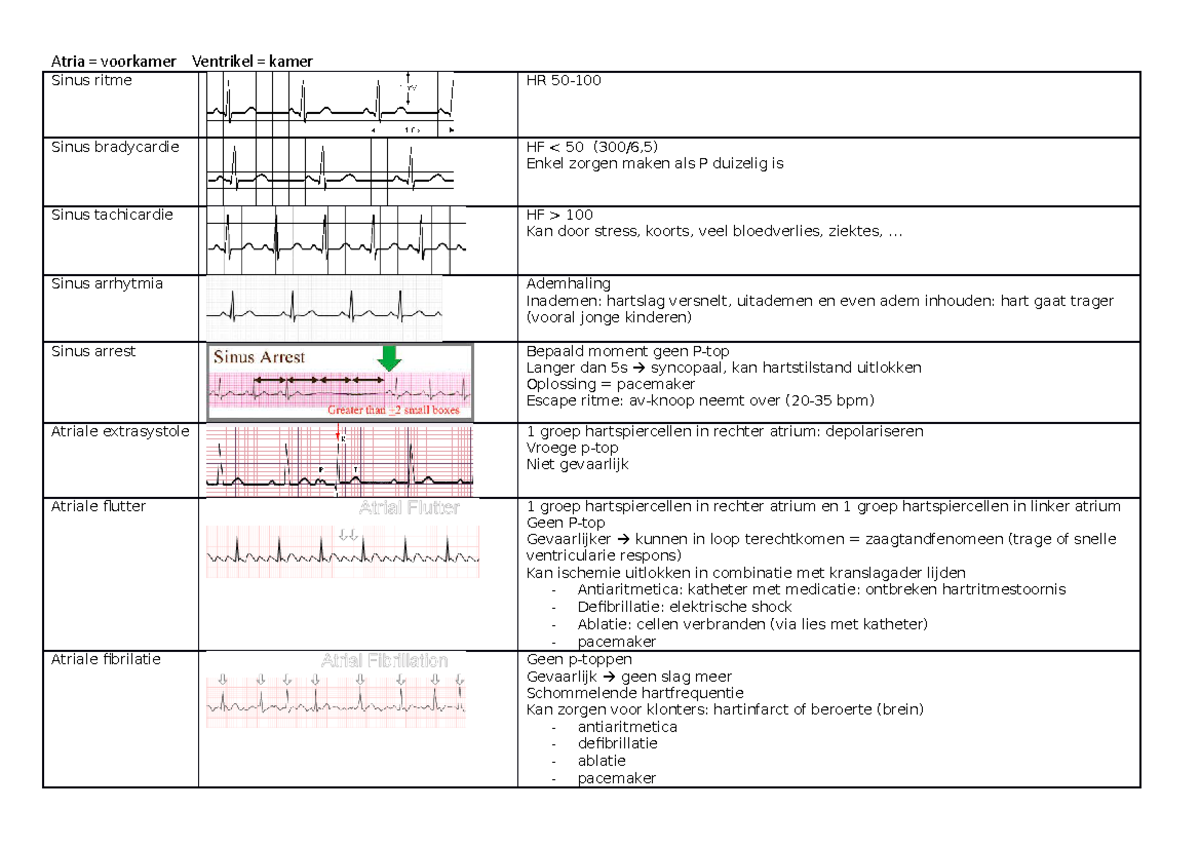 EKG overzicht - Sinus ritme HR 50- Sinus bradycardie HF