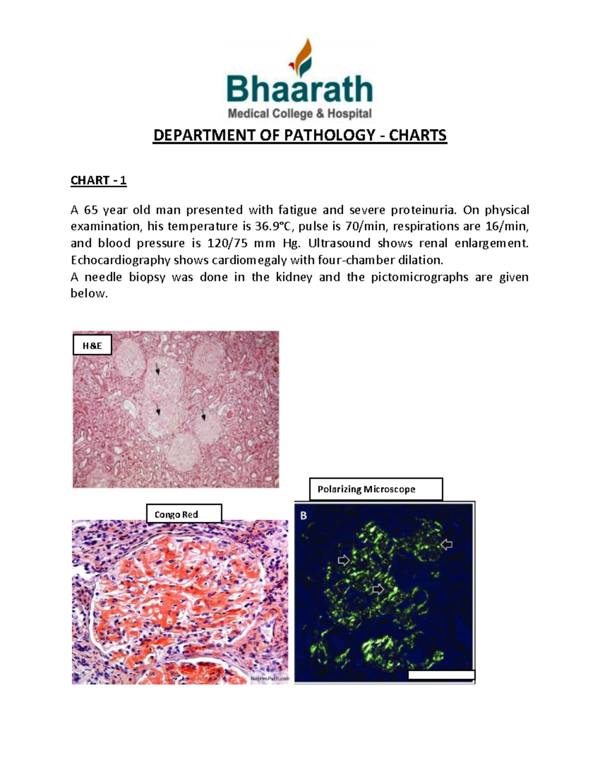 Pathology Charts Chart 1 A 65 Year Old Man Presented With Fatigue And Severe Proteinuria On