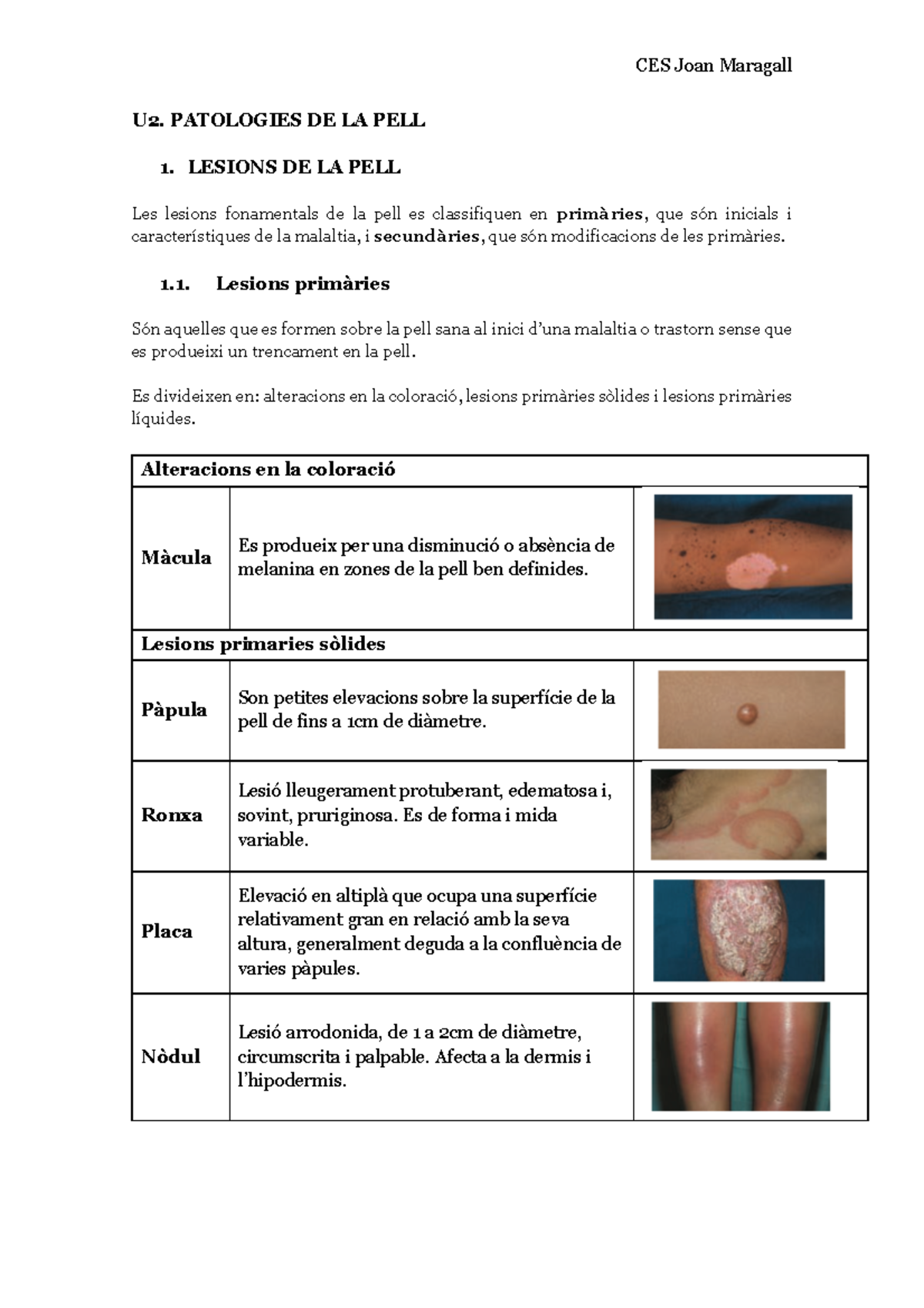 Dossier patologies més importants de la pell - U2. PATOLOGIES DE LA PELL 1. LESIONS DE LA PELL ...