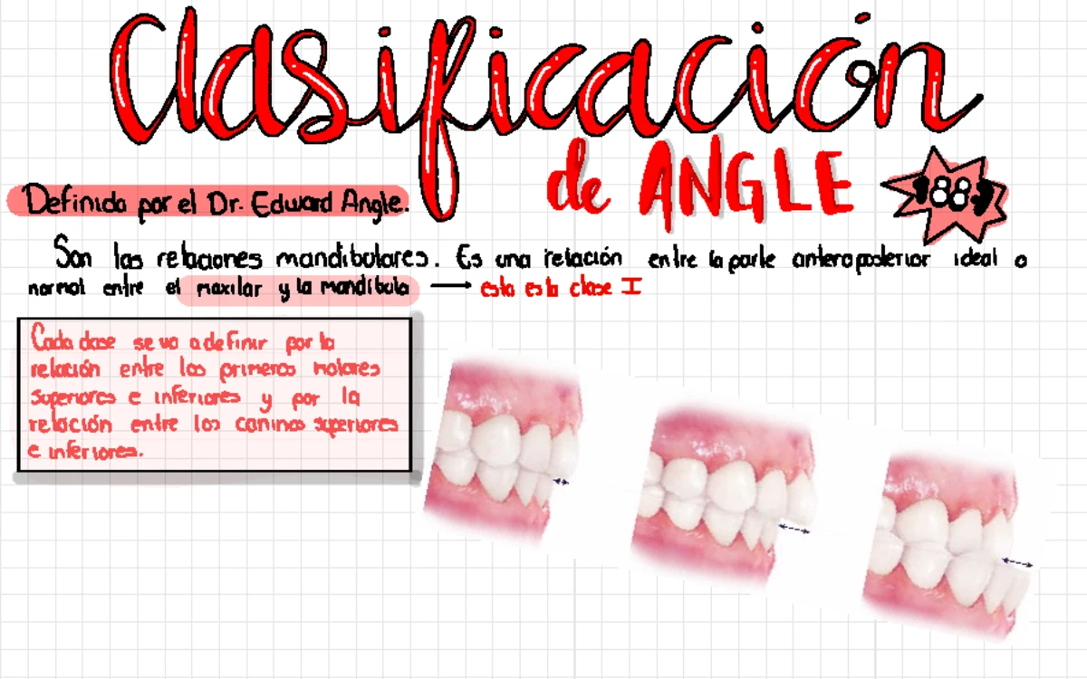 Tipos De Angles Dentales _ Tipos de maloclusión dental: Clase I, II y ...