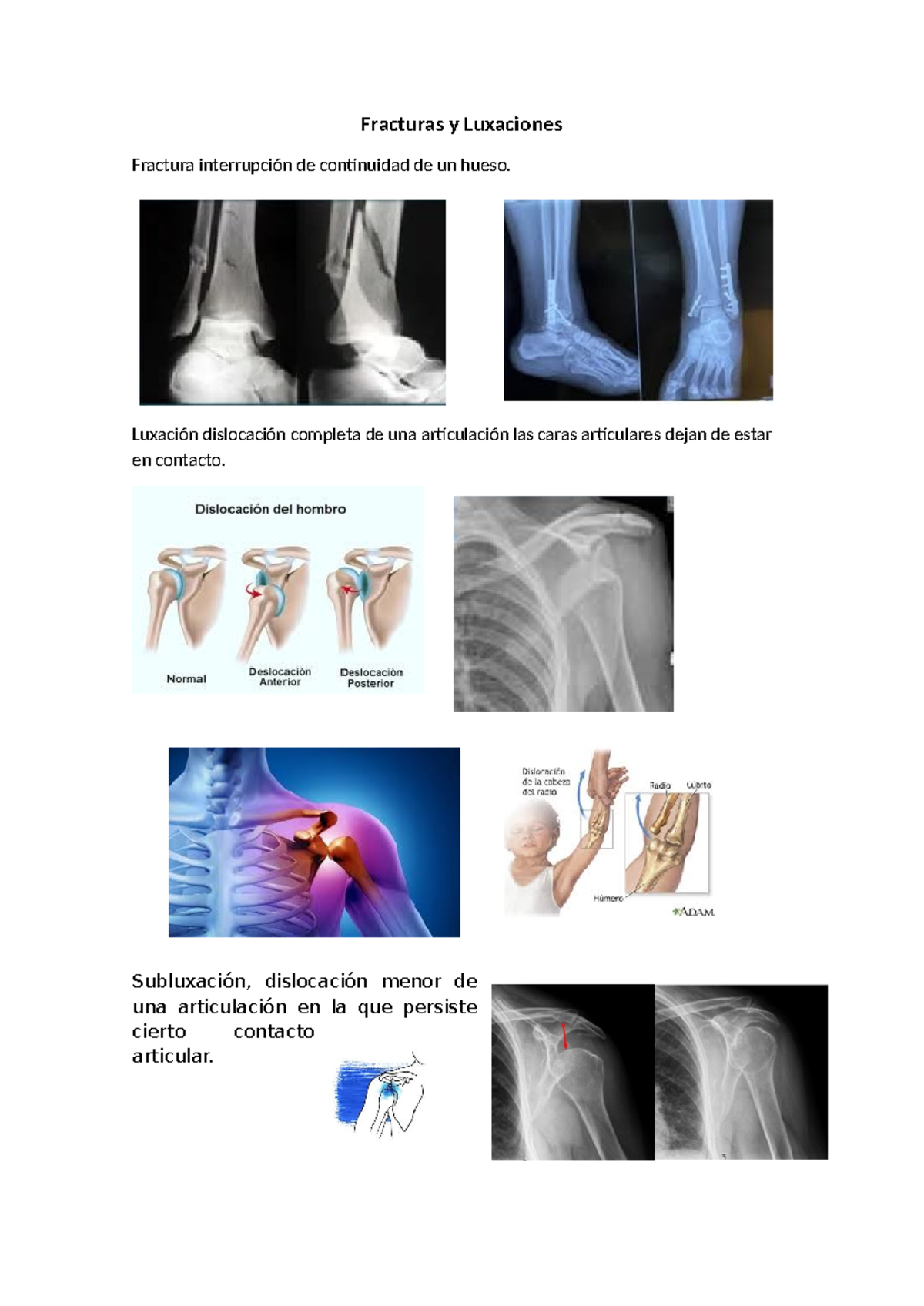Fracturas y Luxaciones - Fracturas y Luxaciones Fractura interrupción de continuidad de un hueso ...