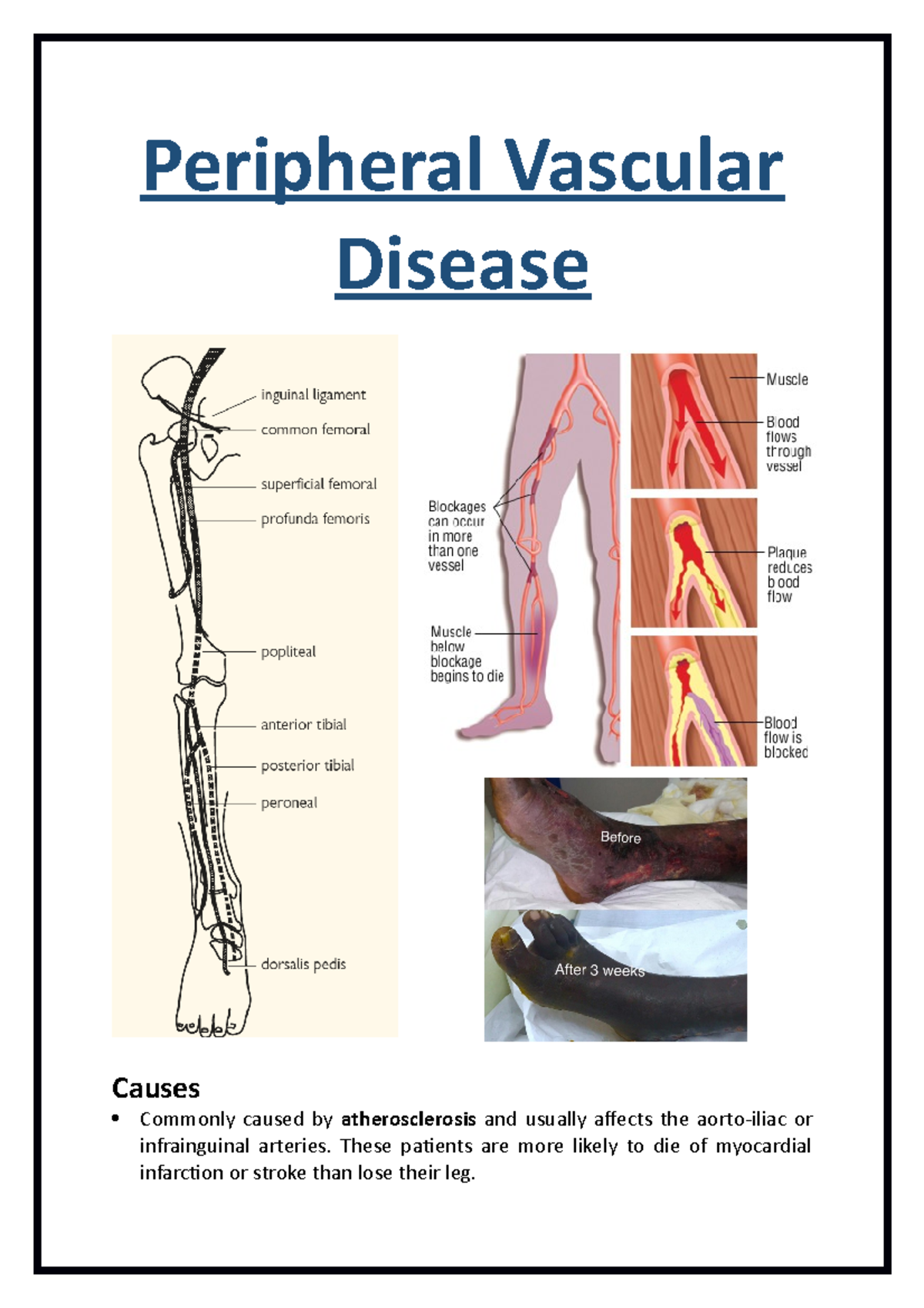 Peripheral Vascular Disease - Peripheral Vascular Disease Causes ...