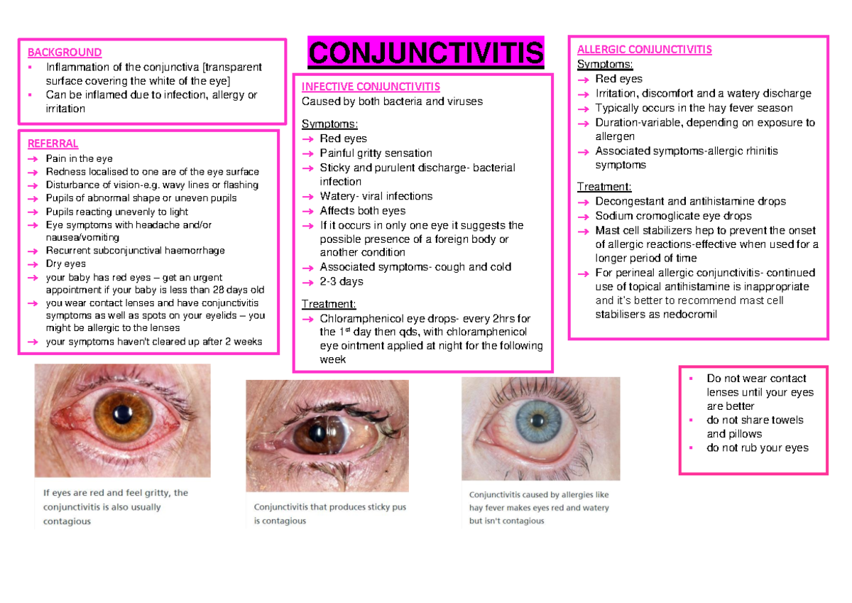 Conjunctivitis RTS - CONJUNCTIVITIS ALLERGIC CONJUNCTIVITIS Symptoms: → ...