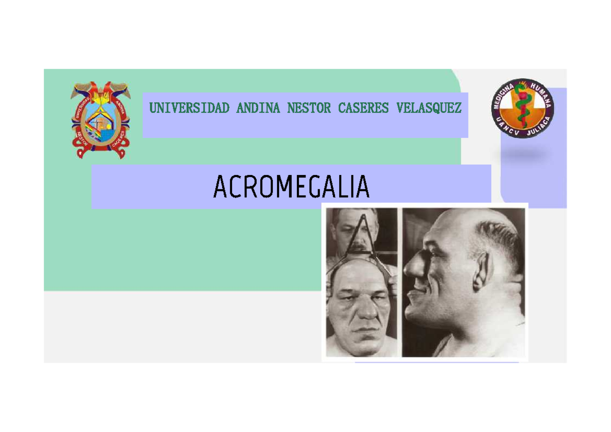 Acromegalia - Es una patología rara, crónica y progresiva , se inicia ...