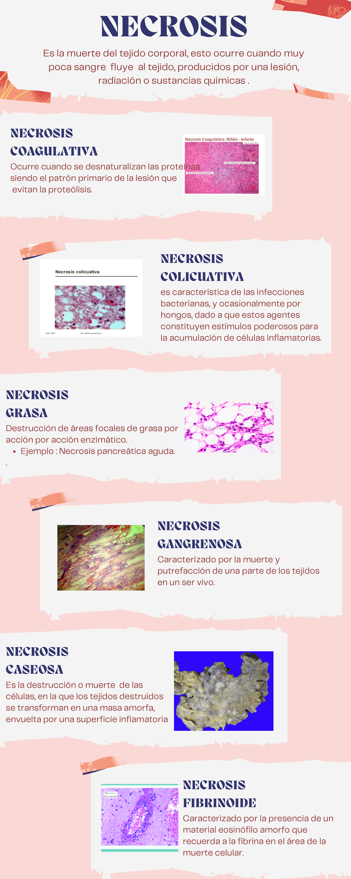 Infografía Necrosis Franz Villarreal - NECROSIS Es la muerte del tejido ...