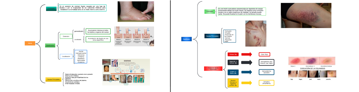 Edema Y Equimosis - usalo - generalizado Edema Clasificacion Concepto ...