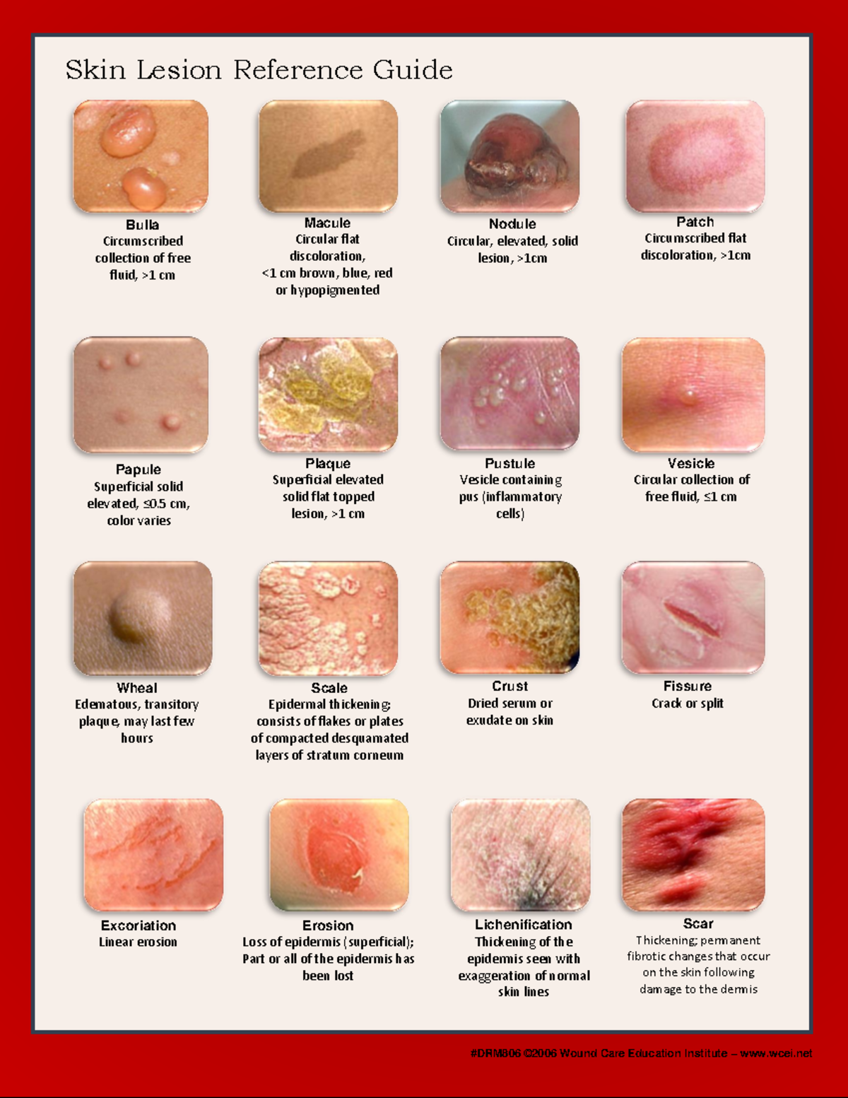 Skin Lesion Chart-1 - Skin Lesion Reference Guide Bulla Circumscribed ...