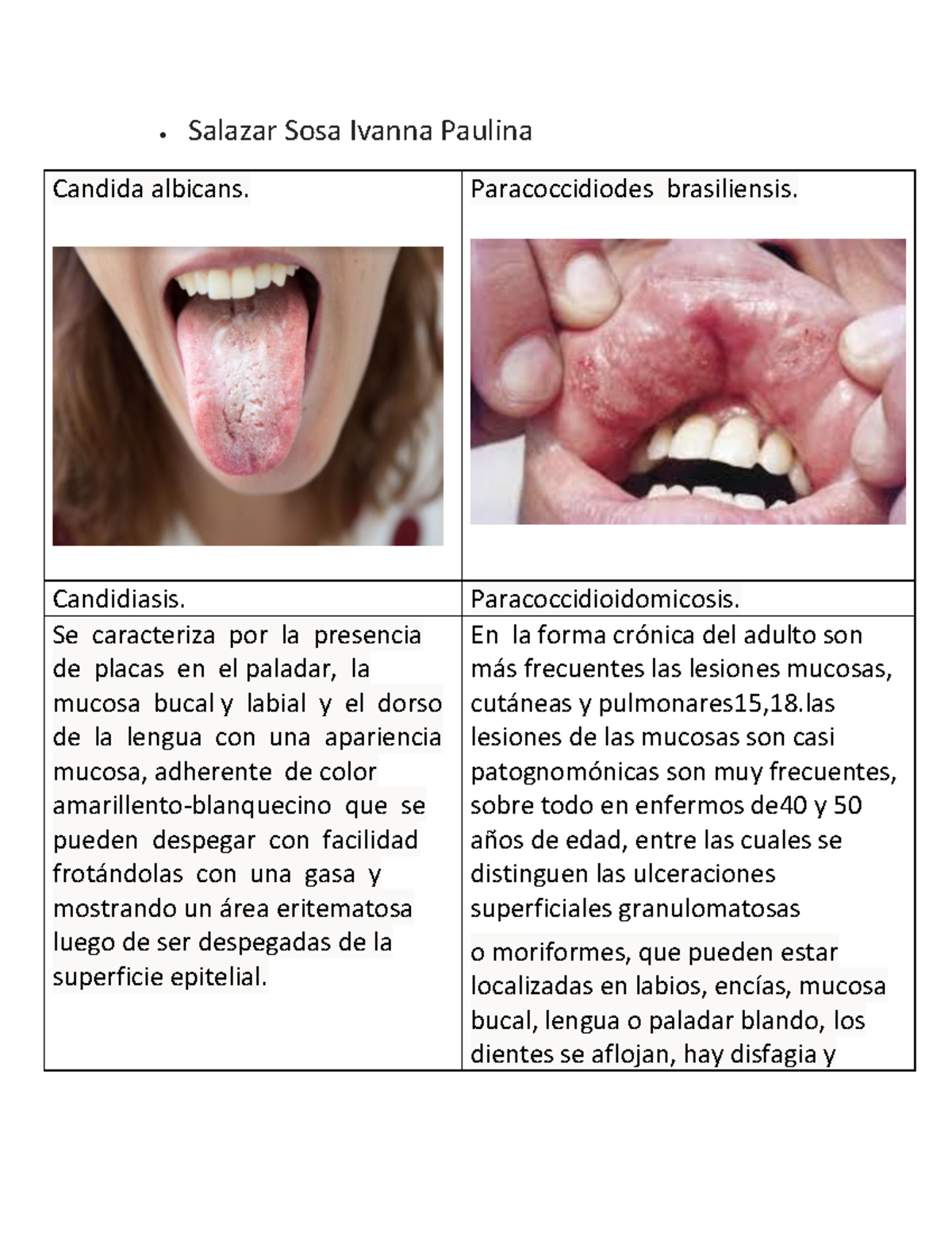 Enfermedades orales por micosis - Salazar Sosa Ivanna Paulina Candida ...