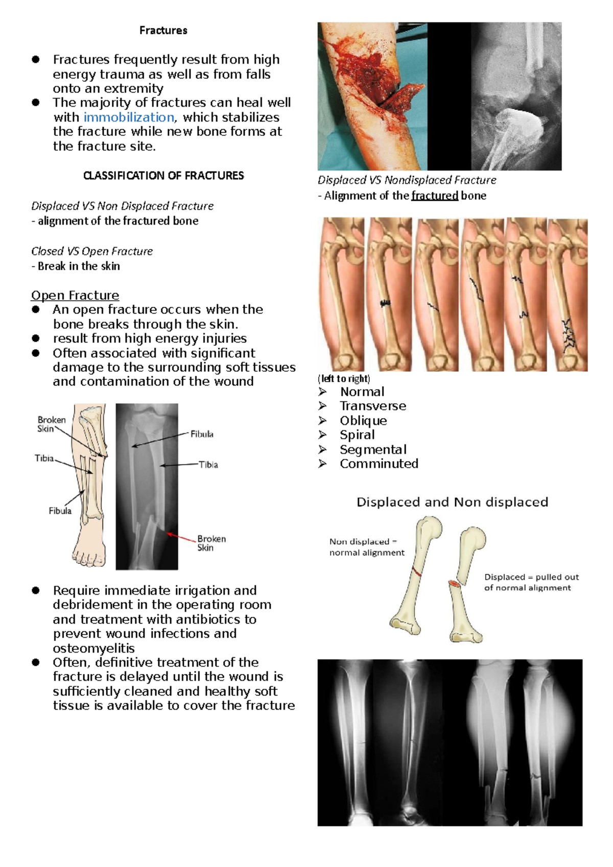 Fractures-notes - lol - Fractures Fractures frequently result from high ...