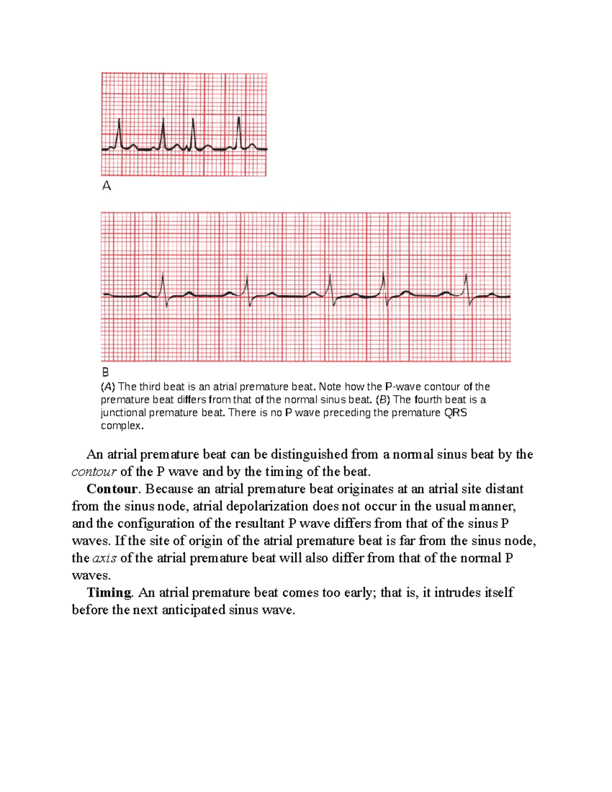 The only EKG-48 - (A) The third beat is an atrial premature beat. Note ...
