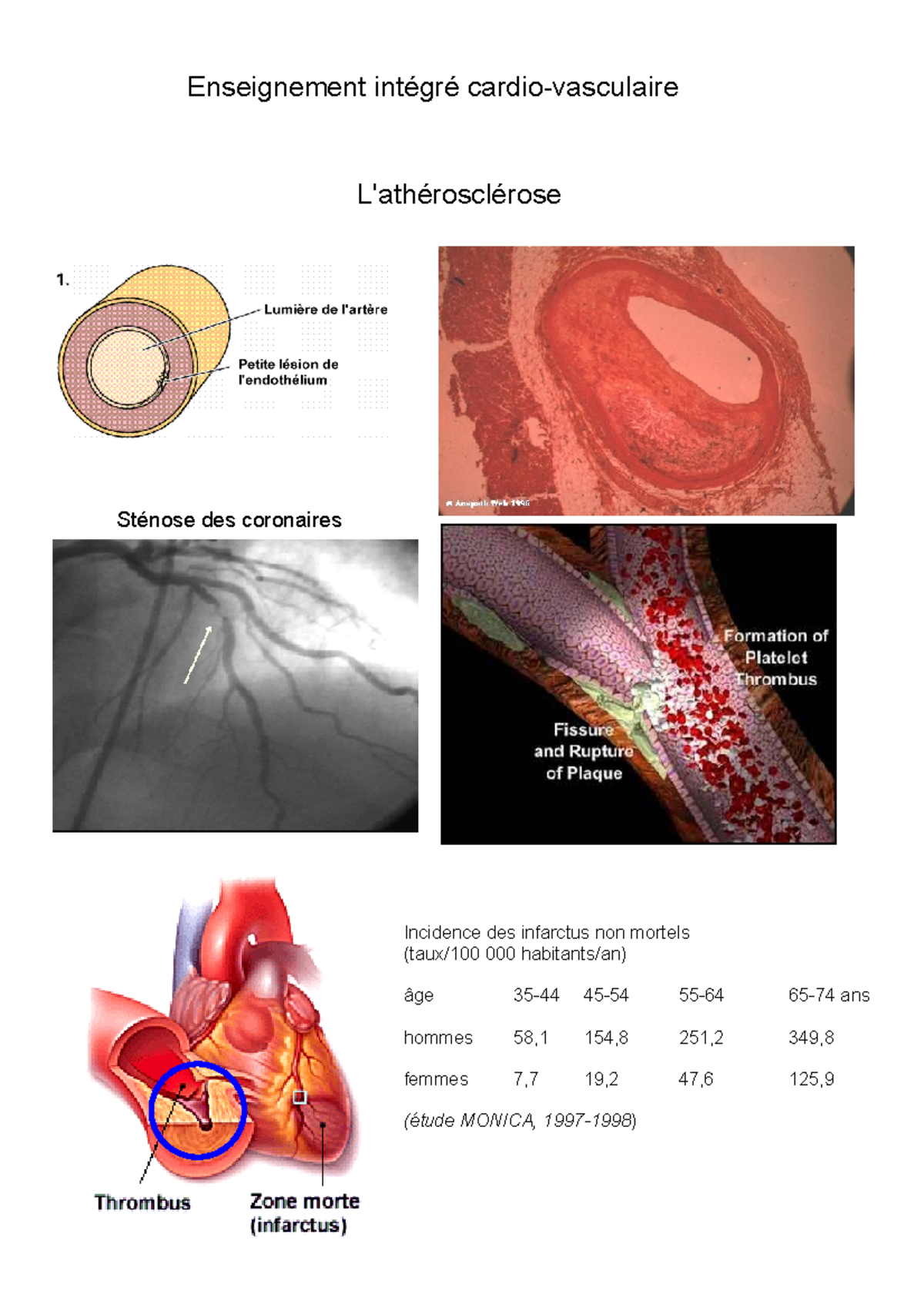 Poly cardiovasc id 08 1199902935904 - L'athérosclérose Sténose des ...