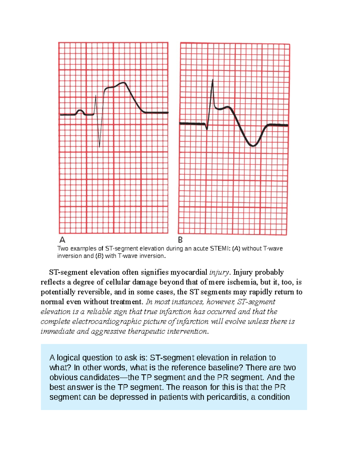 The only EKG-84 - The only EKG - Two examples of ST-segment elevation ...