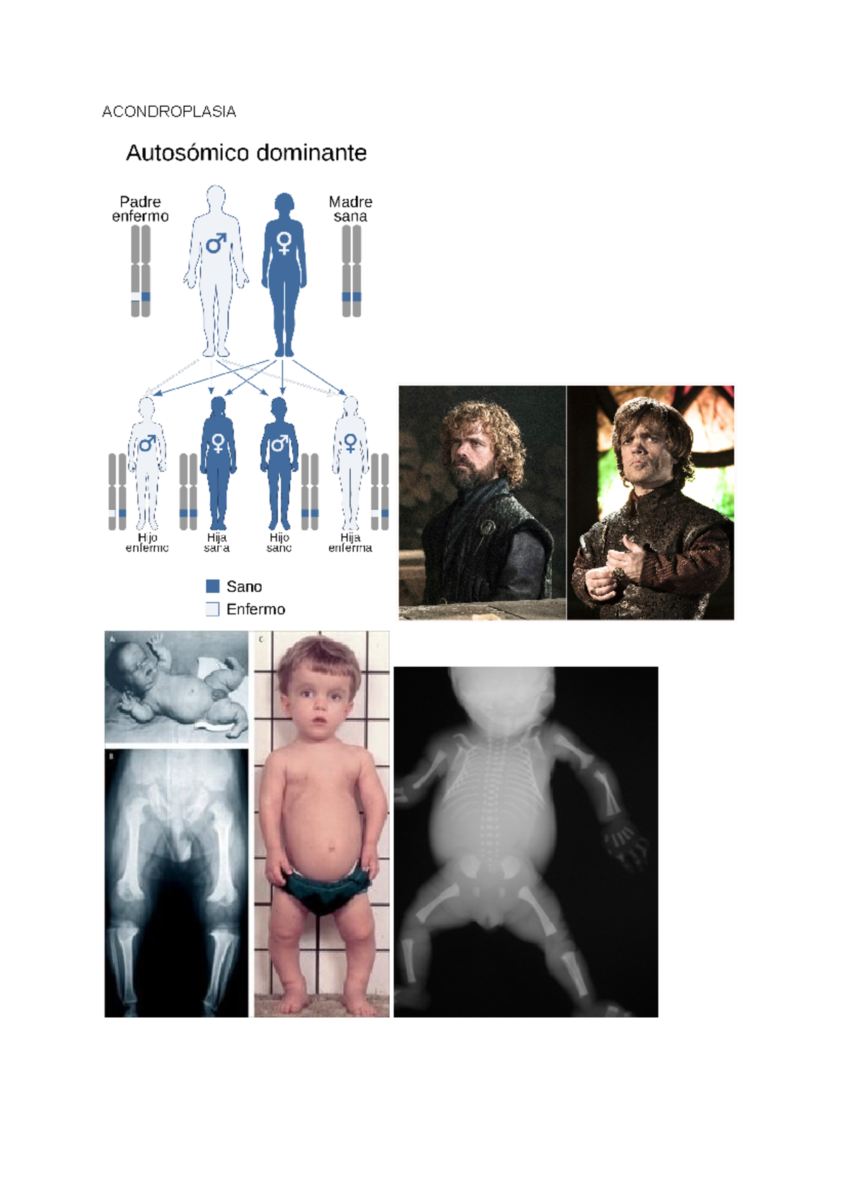 Imagenes Genética - ACONDROPLASIA MARFAN TREACHER COLLIN APERT EPILOIA ...