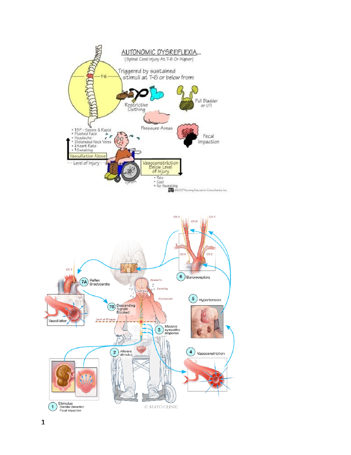 Autonomic Dysreflexia - Severely elevated blood pressure can cause a ...