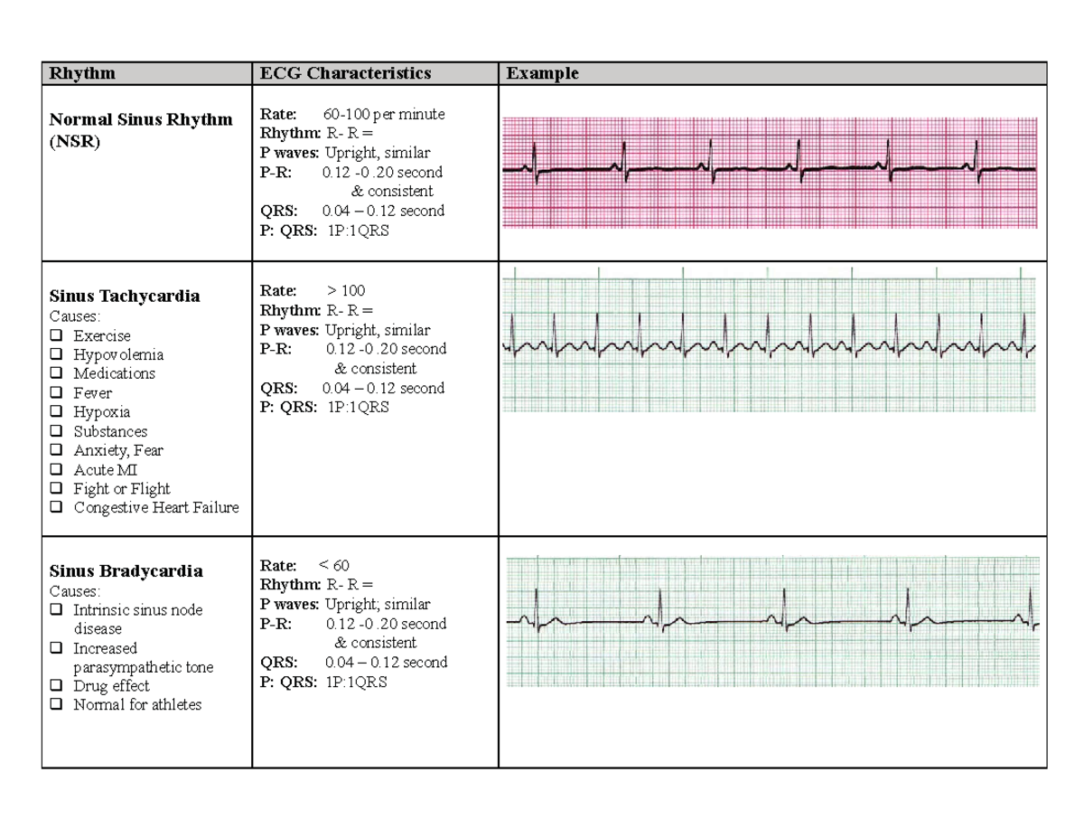 EKG Cheat Sheet - EKG - Normal Sinus Rhythm (NSR) Rate: 60-100 per ...