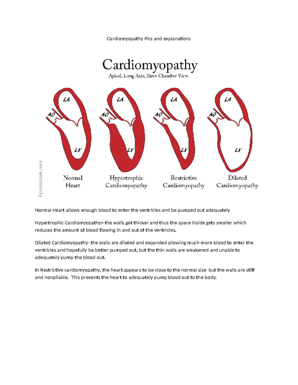 Cardiomyopathy Pics and explanations - Dilated Cardiomyopathy- the ...