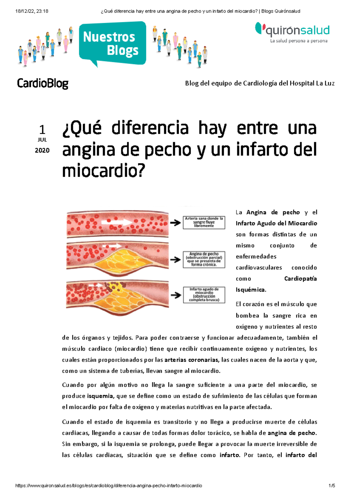 ¿Qué diferencia hay entre una angina de pecho y un infarto del ...