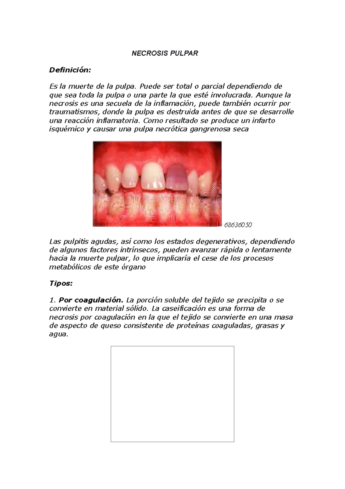 Necrosis - ODONTOPEDIATRIA - NECROSIS PULPAR Definición: Es la muerte ...