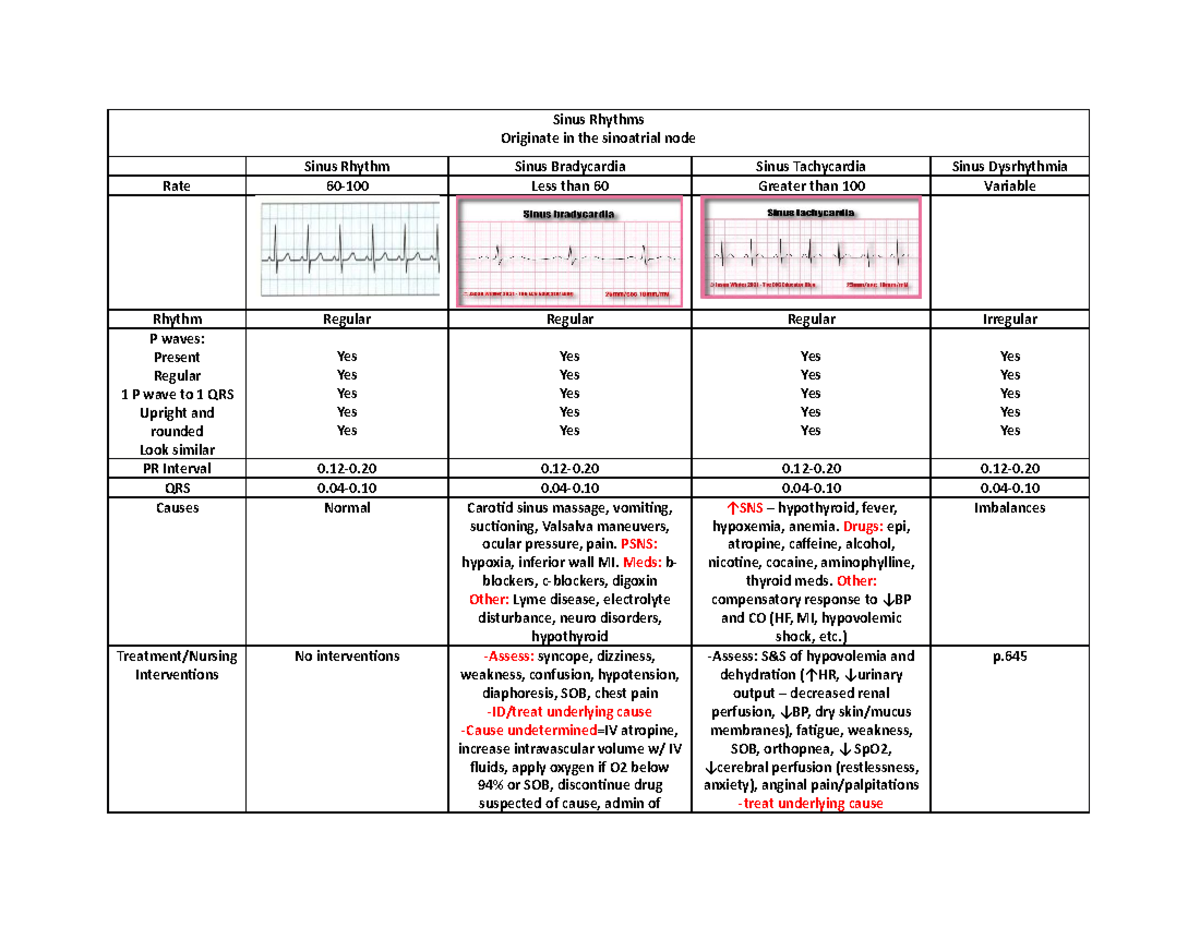 ECG-EKG Basics - Sinus Rhythms Originate in the sinoatrial node Sinus ...
