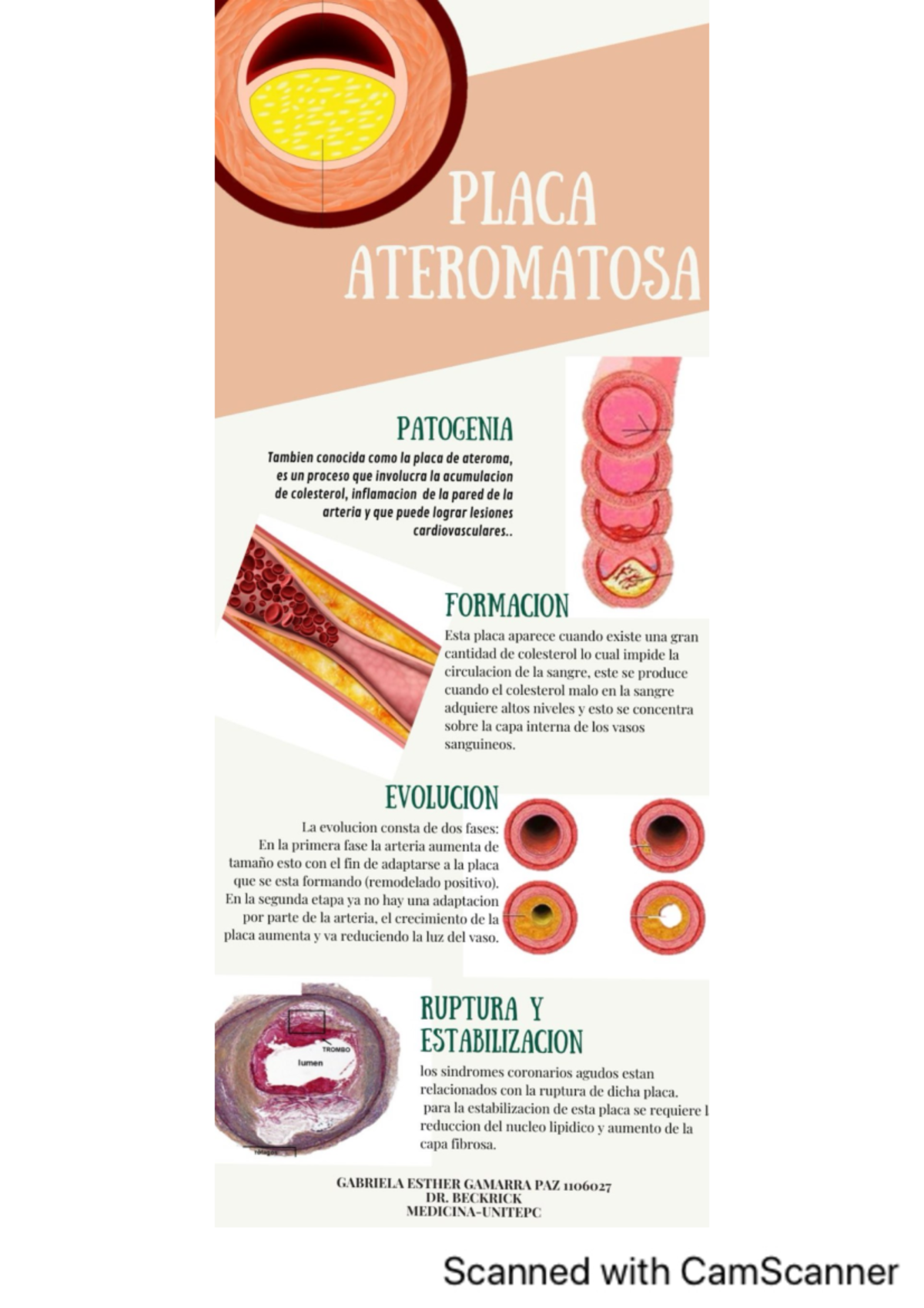 Placa de ateroma 11 - Medicina - Studocu