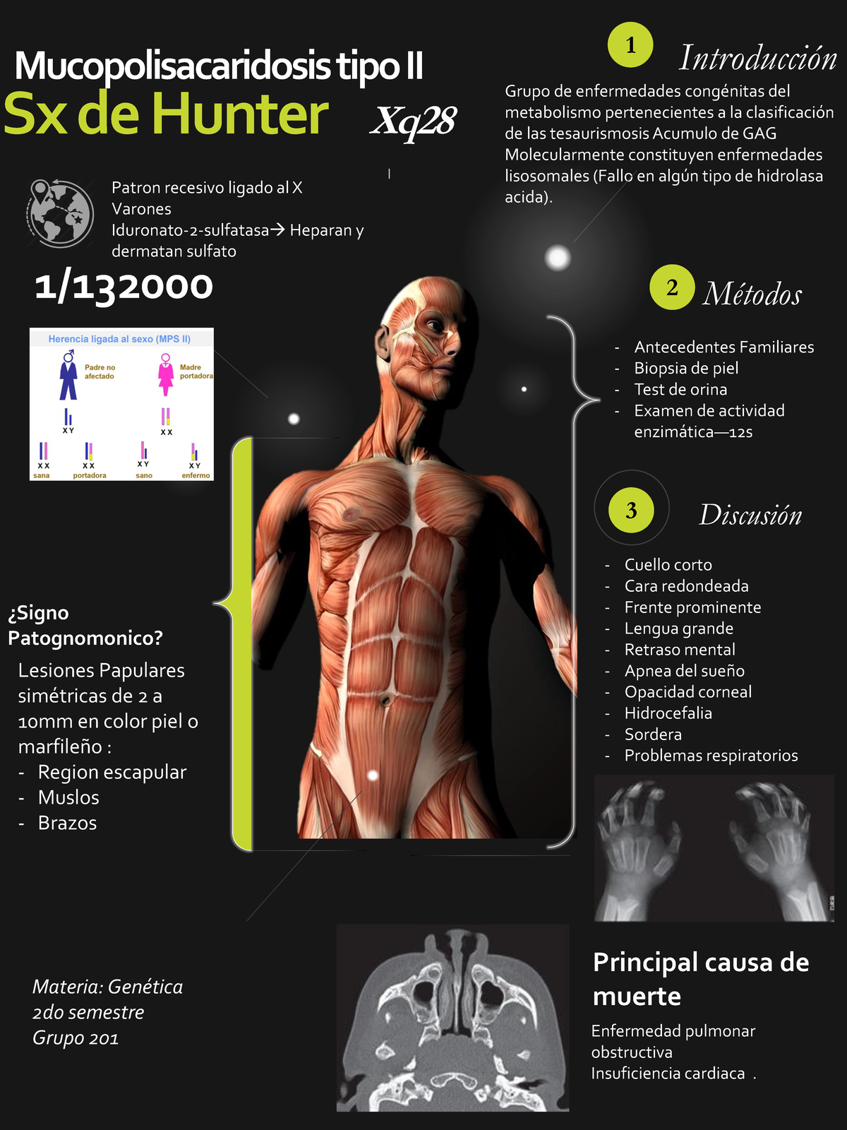 Cartel de MPSII - Sx de Hunter Xq Mucopolisacaridosis tipo II 1/ Patron ...