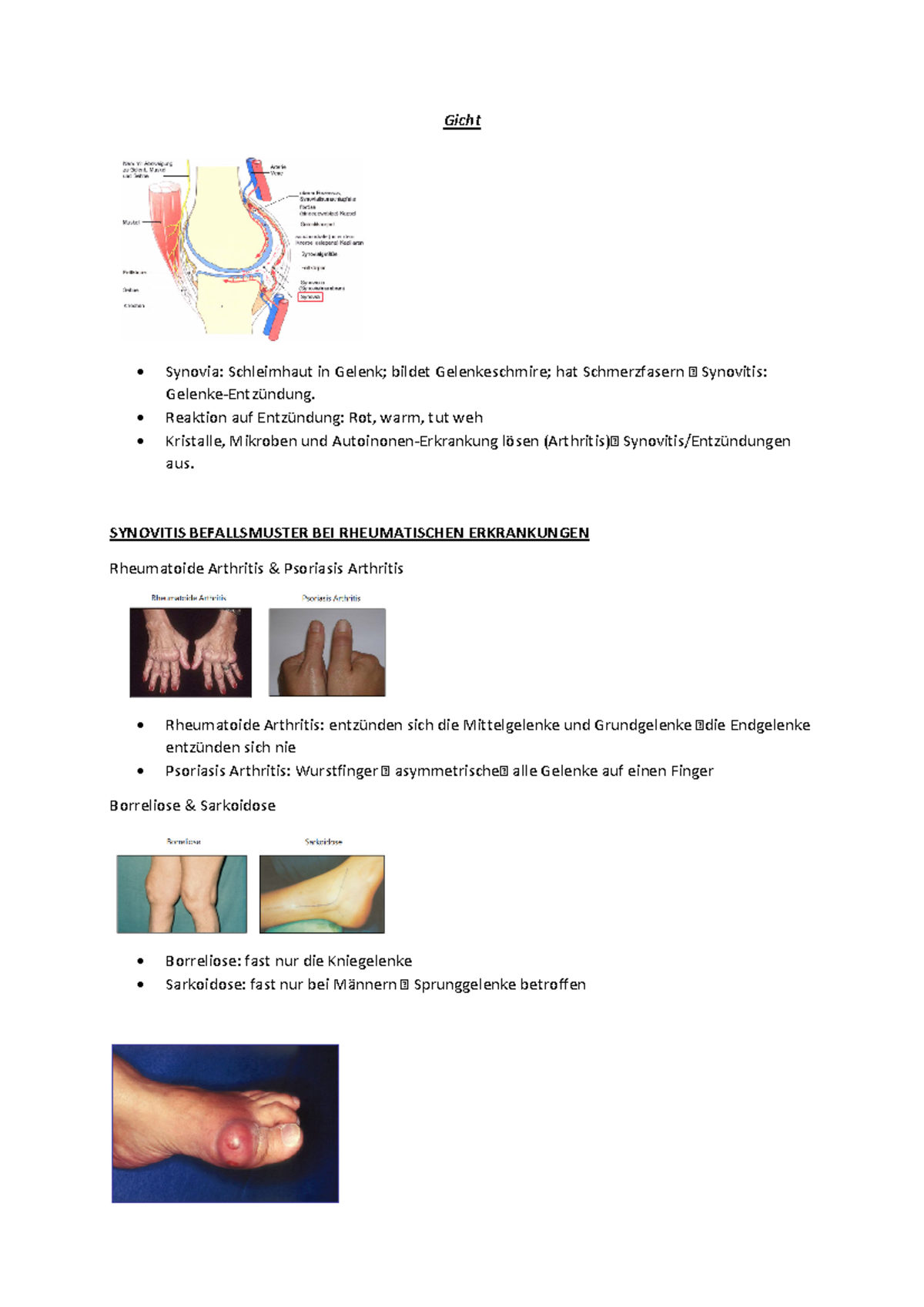 Gicht - Gicht ÷ Synovia: Schleimhaut in Gelenk; bildet Gelenkeschmire ...