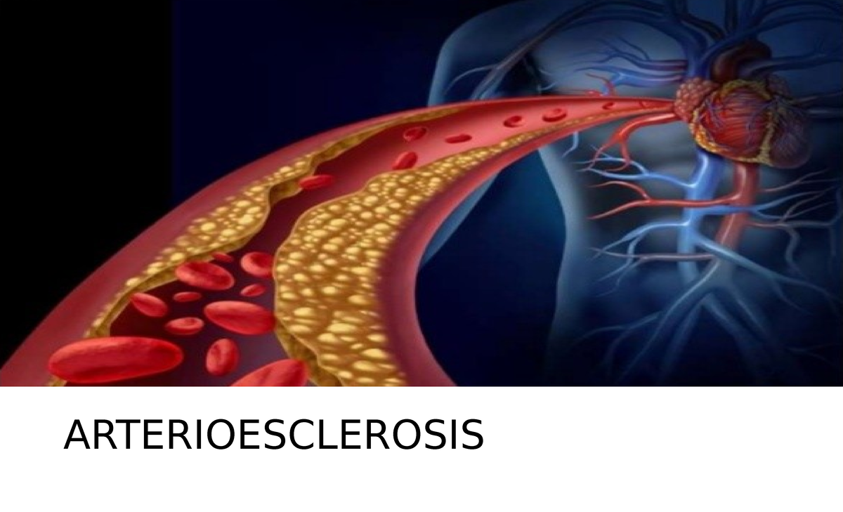 Arterioesclerosis - MEDICINA INTERNA - MÁS BREVE - Medicina Interna ...