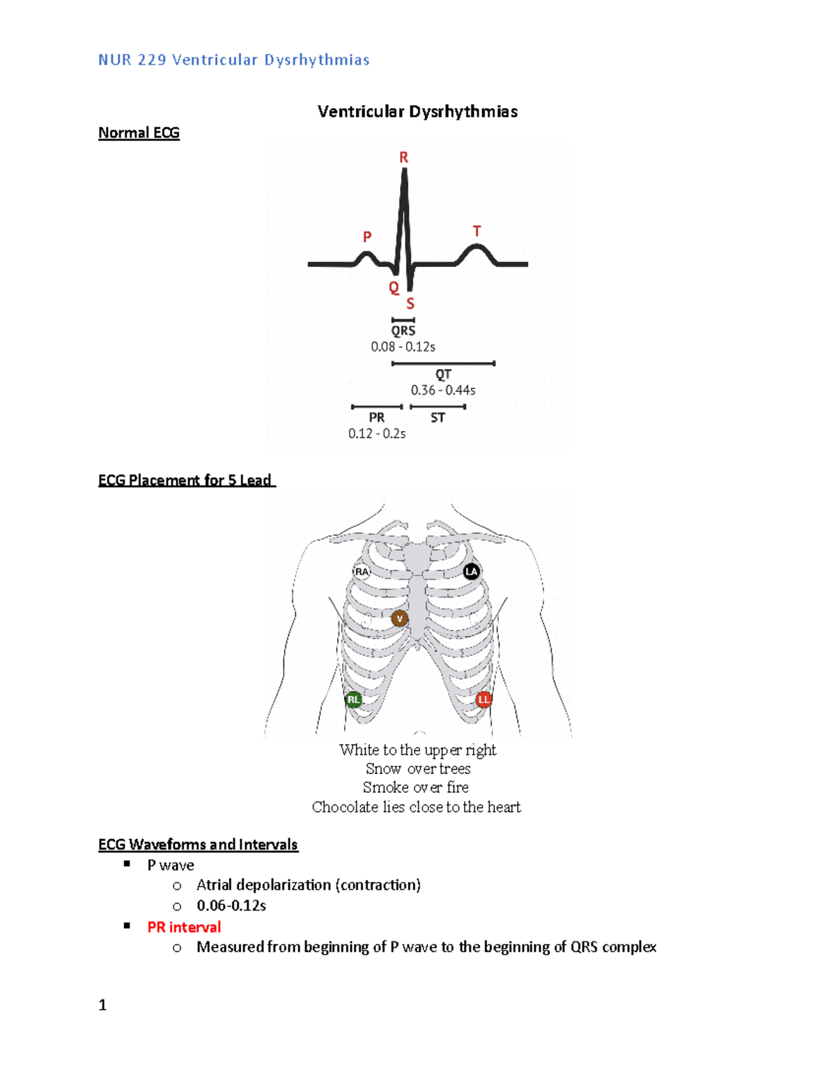 NUR 229 Ventricular Dysrhythmias - Ventricular Dysrhythmias Normal ECG ...