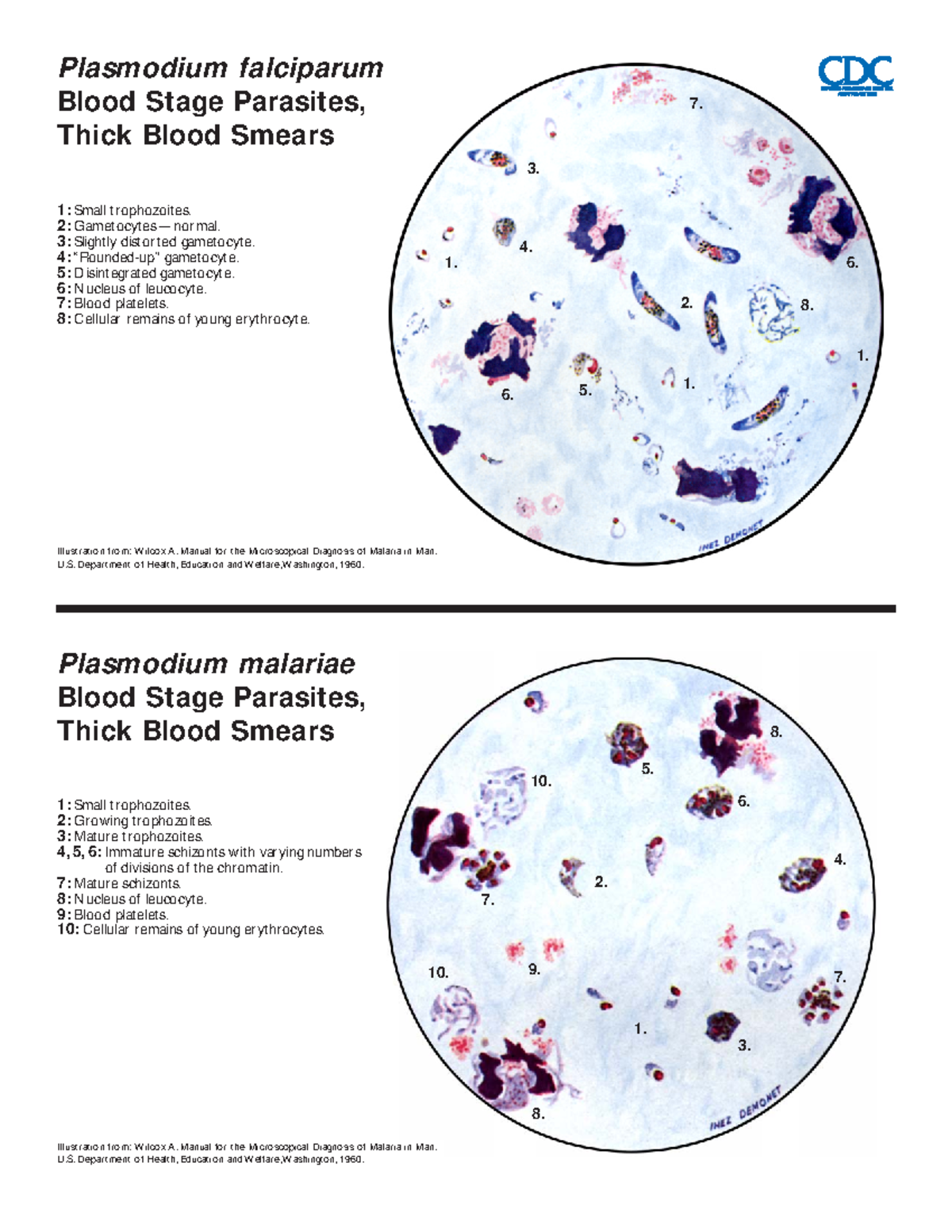 Malaria Comparison p7-8 - 1:Small trophozoites. 2:Gametocytes— normal ...